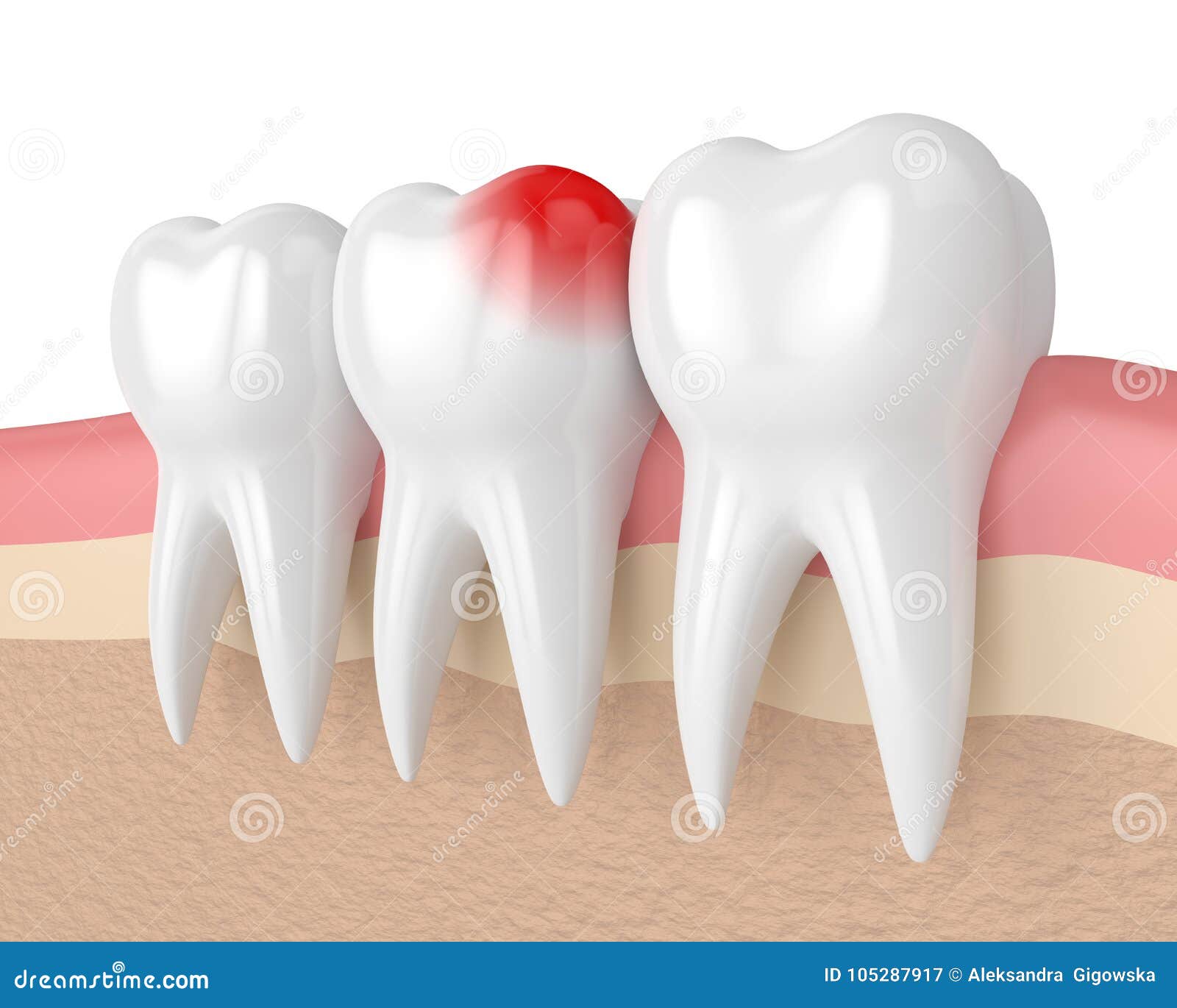 3d Render of Teeth with Toothache in Gums Stock Illustration ...