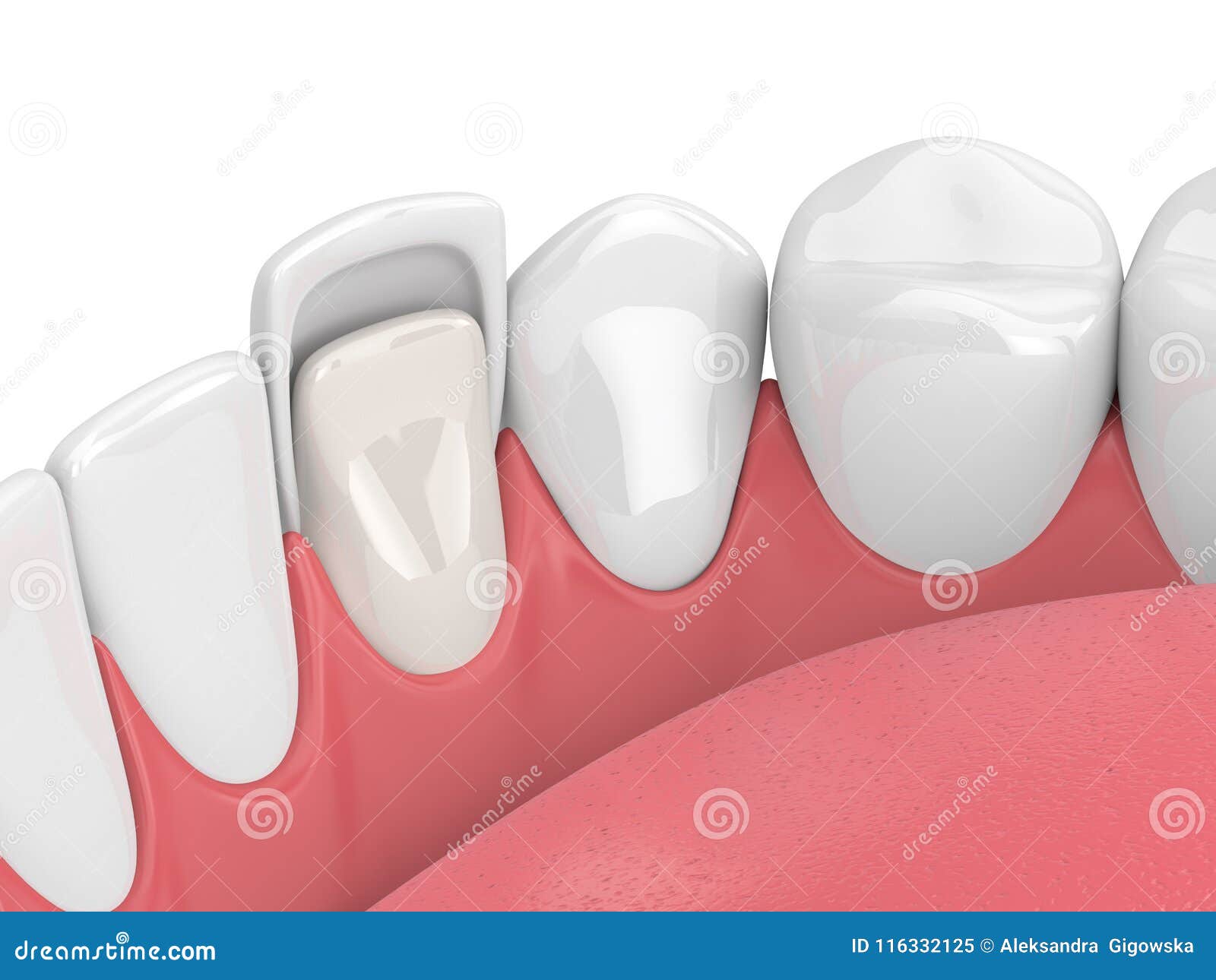 3d Render of Teeth with Veneer Stock Illustration - Illustration of ...