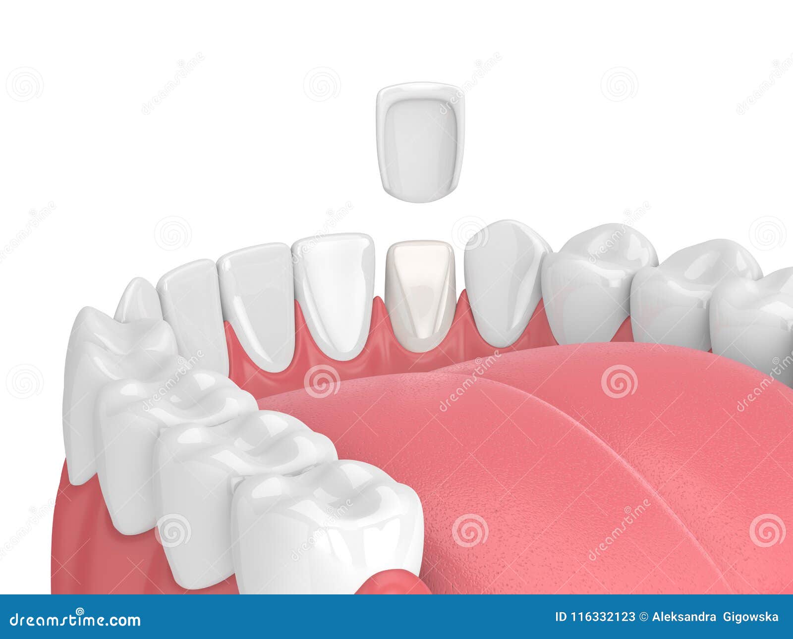 3d Render of Teeth with Veneer Stock Illustration - Illustration of ...