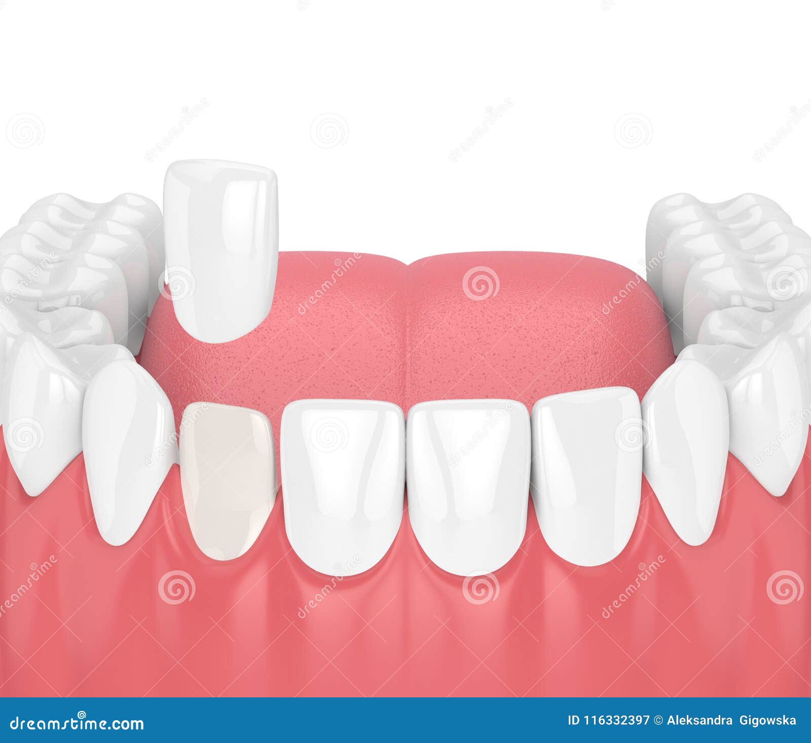3d Render of Teeth with Veneer Stock Illustration - Illustration of ...