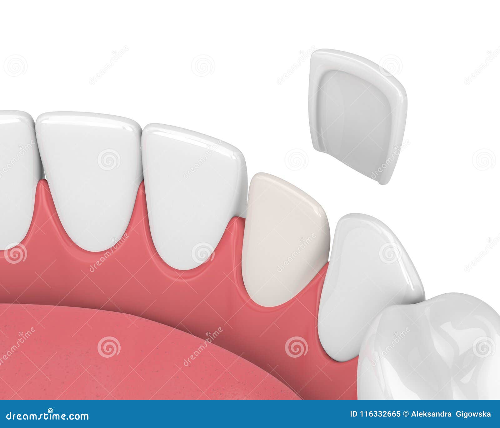3d Render of Teeth with Veneer Stock Illustration - Illustration of ...