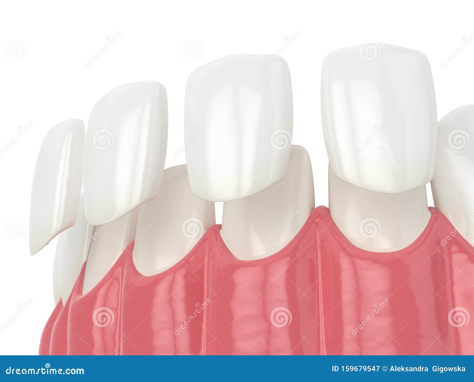 3d Render of Teeth with Veneers Stock Illustration - Illustration of ...