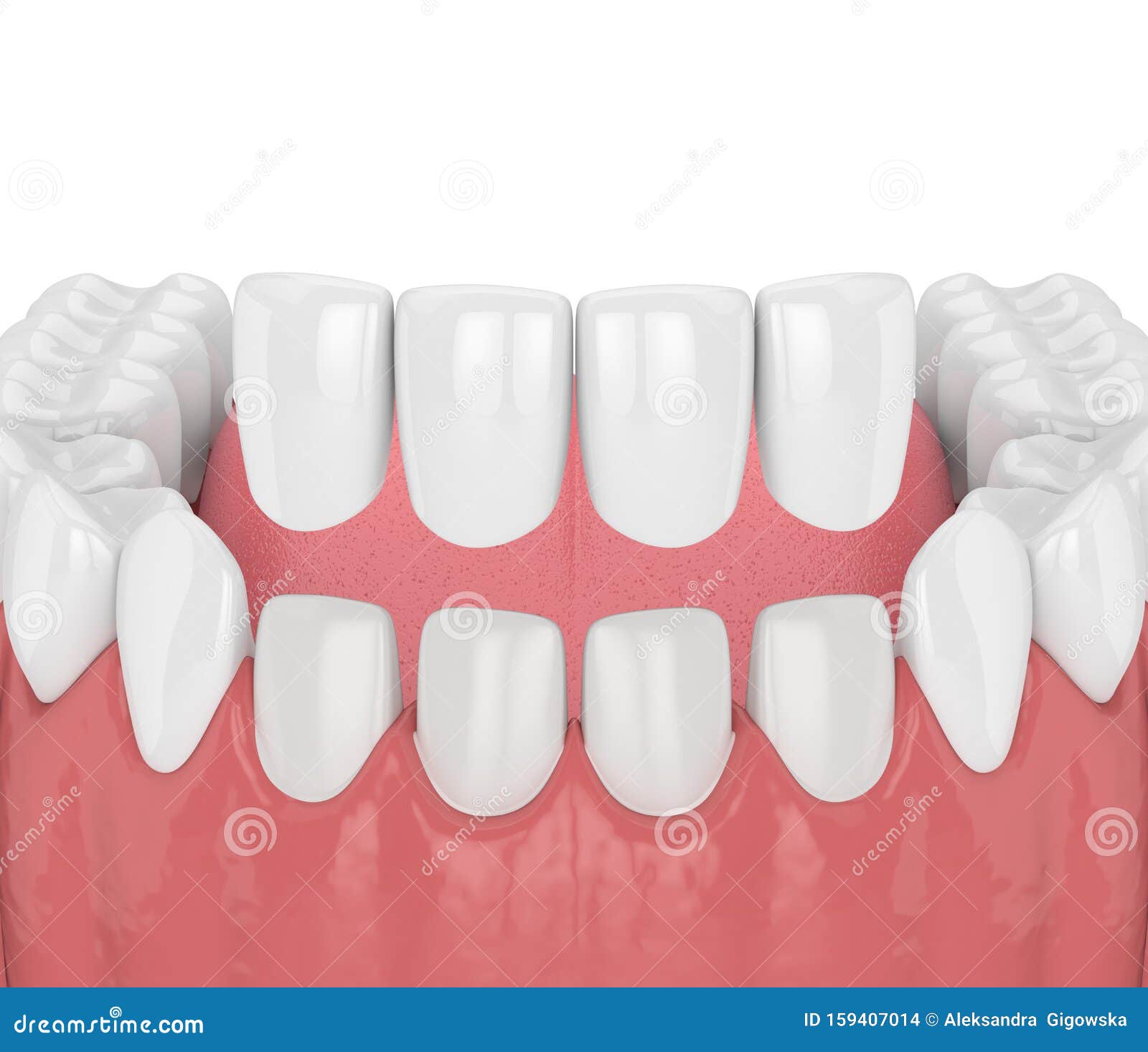 3d Render of Teeth with Veneers Stock Illustration - Illustration of ...