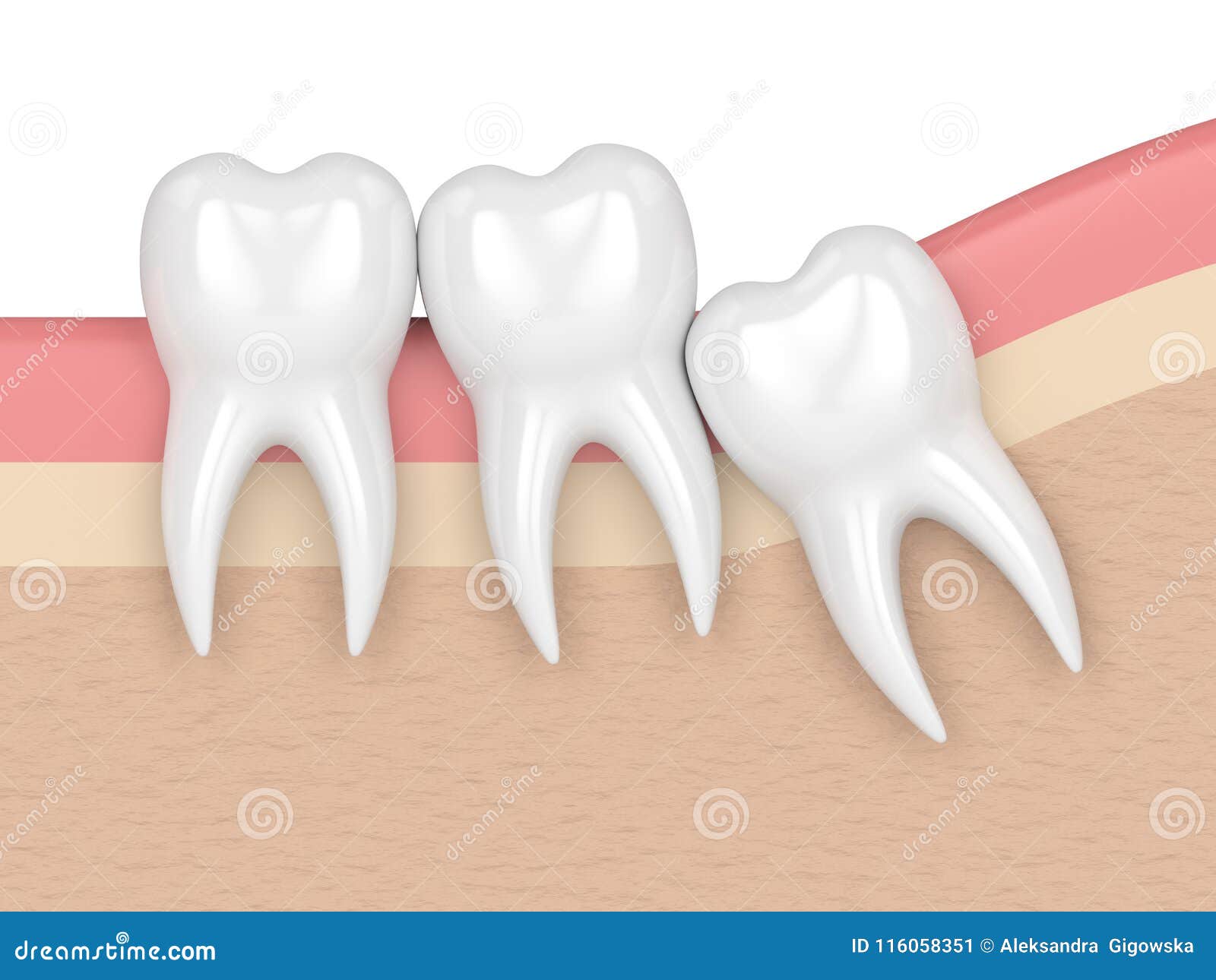 3d Render of Teeth with Wisdom Crowding Stock Illustration ...
