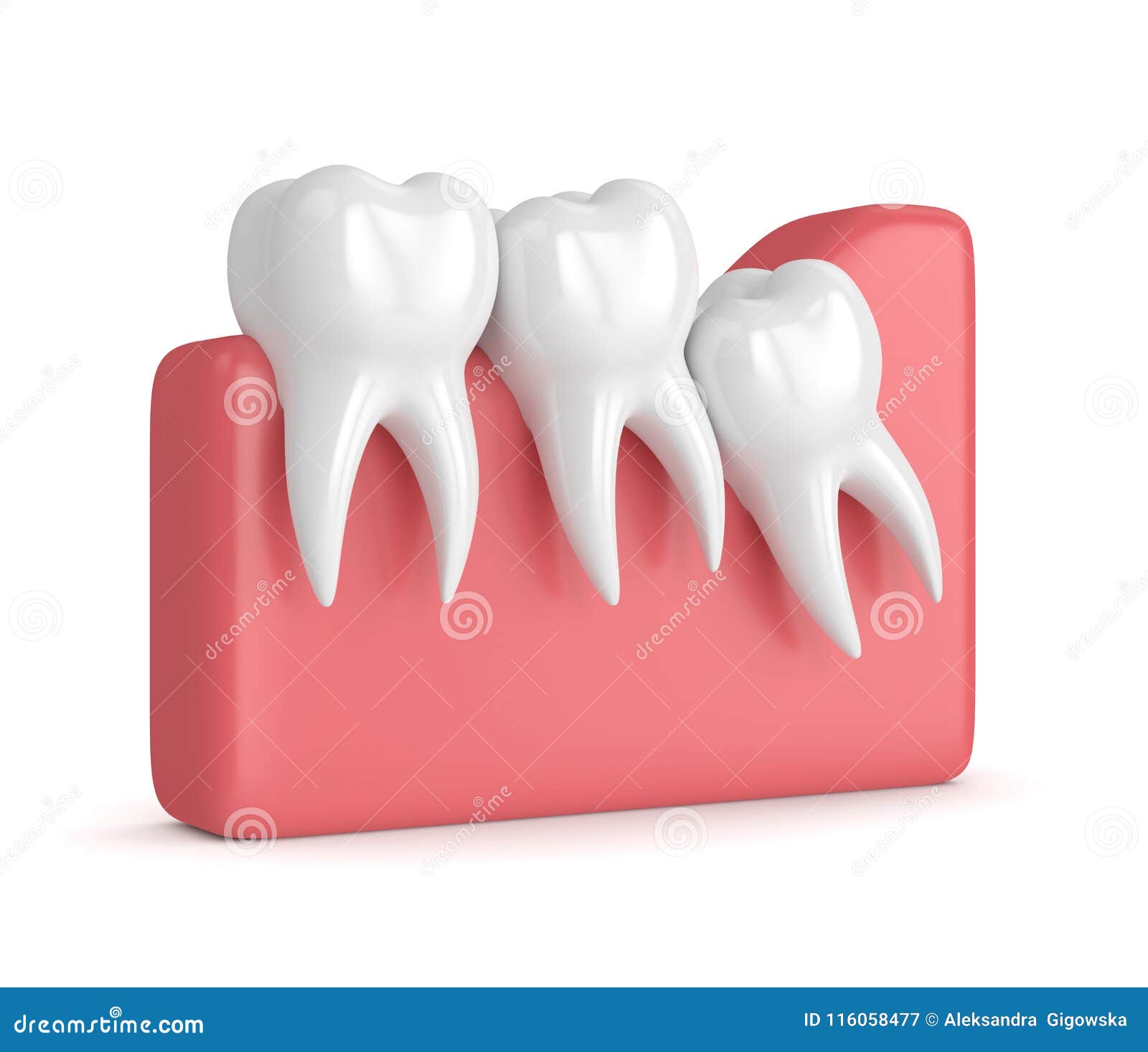 3D Teeth With Wisdom Mesial Impaction Problem Cartoon Vector ...