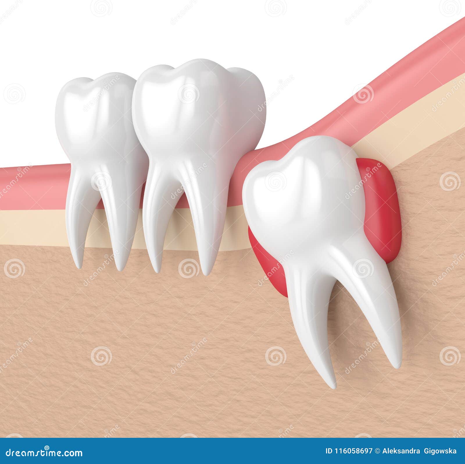 3d Render of Teeth with Wisdom Cyst Stock Illustration - Illustration ...