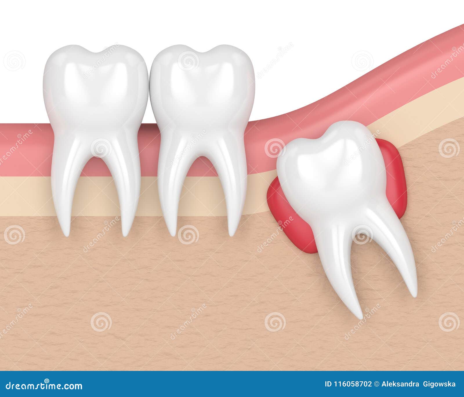 3D Teeth With Wisdom Mesial Impaction Problem Cartoon Vector ...
