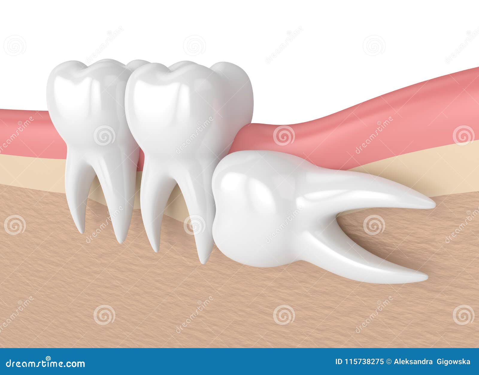 3d Render of Teeth with Wisdom Horizontal Impaction Stock Illustration ...