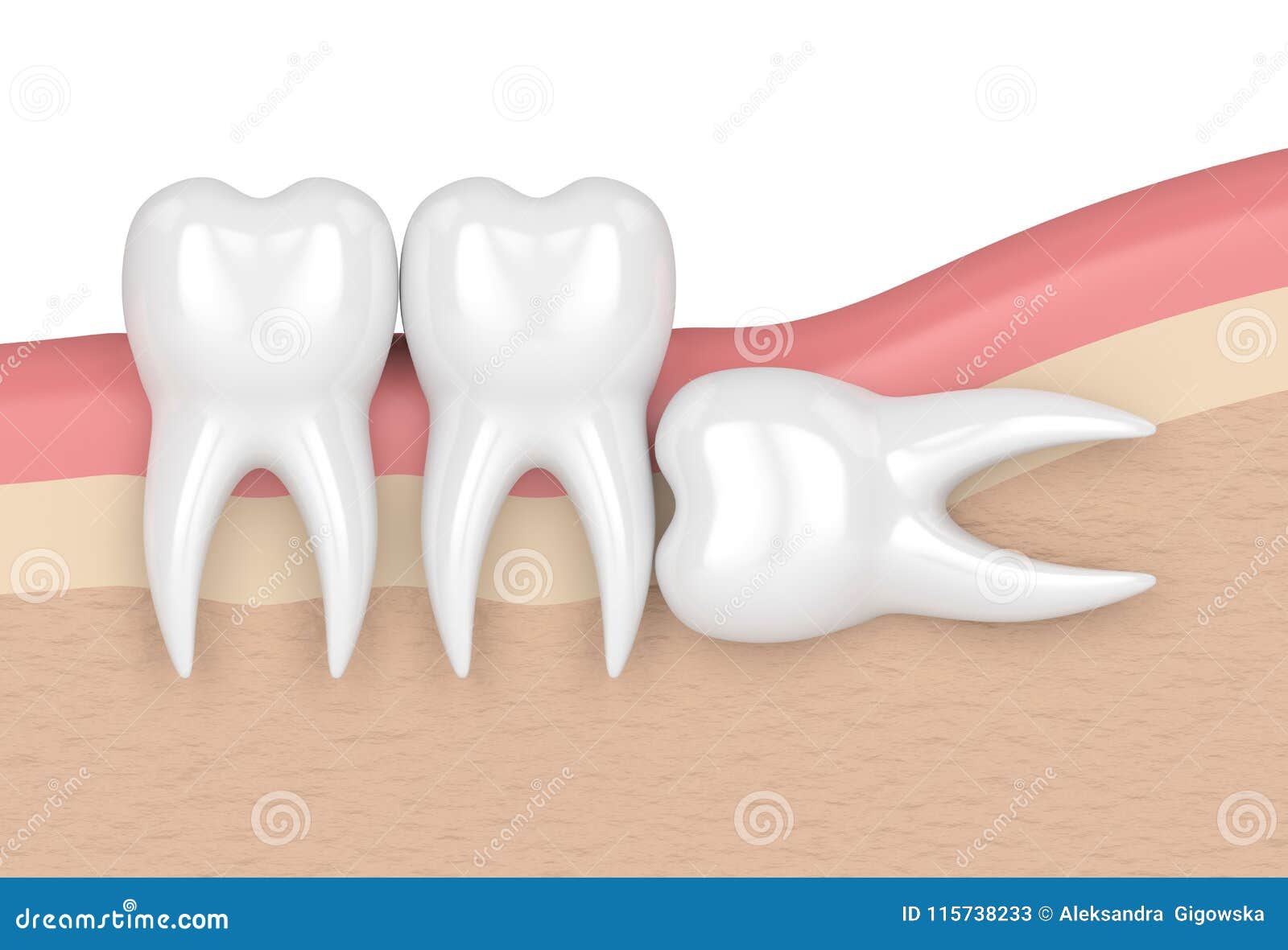 3d Render of Teeth with Wisdom Horizontal Impaction Stock Illustration ...