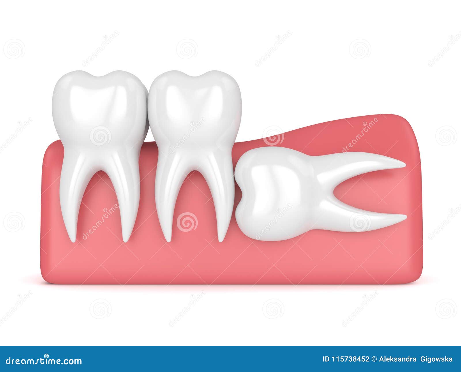 3d Render of Teeth with Wisdom Horizontal Impaction Stock Illustration ...
