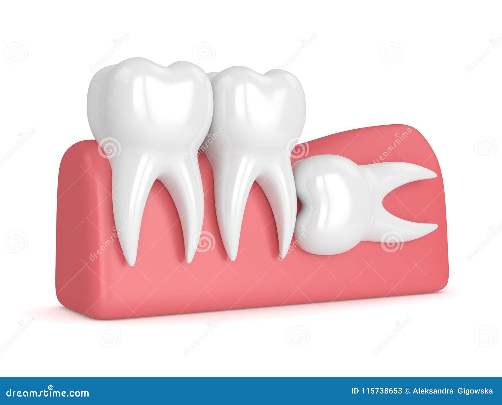 3d Render of Teeth with Wisdom Horizontal Impaction Stock Illustration ...