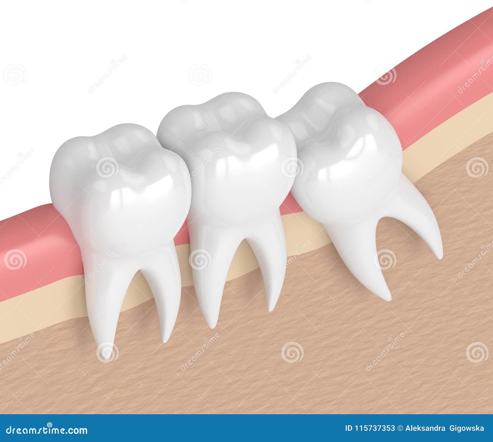 3d Render of Teeth with Wisdom Mesial Impaction Stock Illustration ...