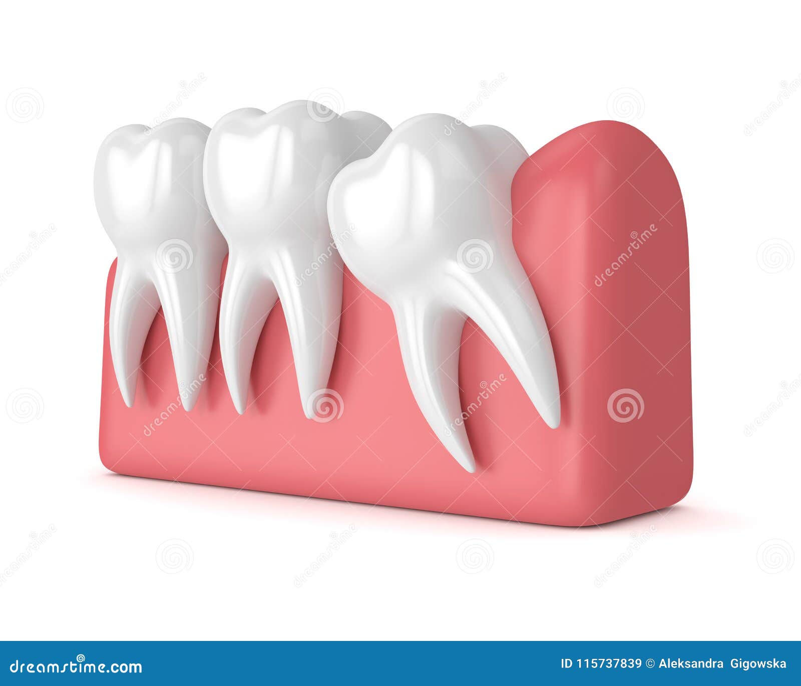 3d Render of Teeth with Wisdom Mesial Impaction Stock Illustration ...