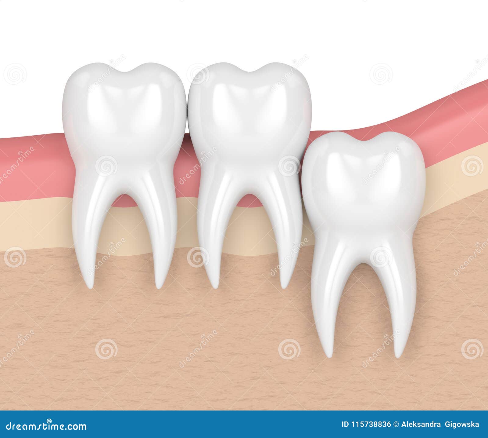3d Render of Teeth with Wisdom Vertical Impaction Stock Illustration ...