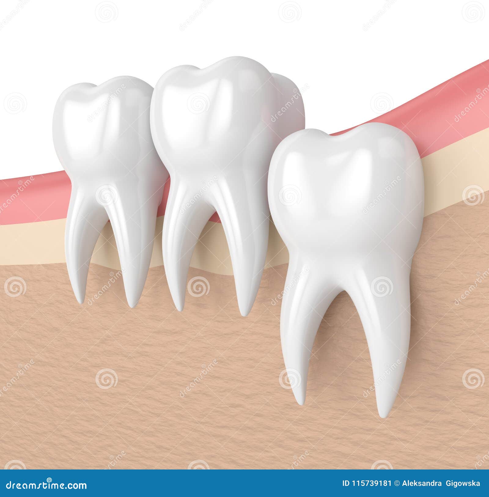 3d Render of Teeth with Wisdom Vertical Impaction Stock Illustration ...