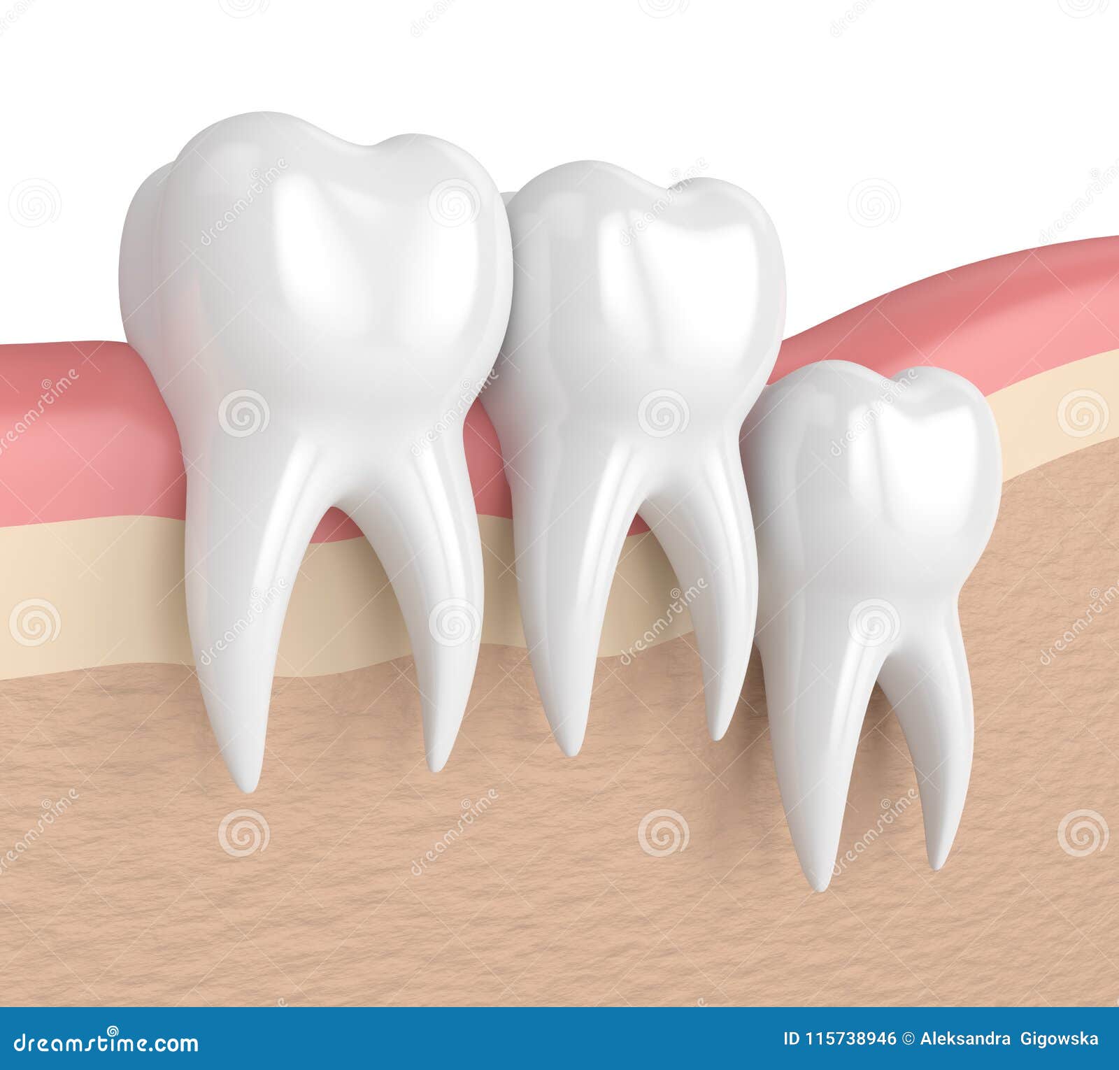 3d Render of Teeth with Wisdom Vertical Impaction Stock Illustration ...