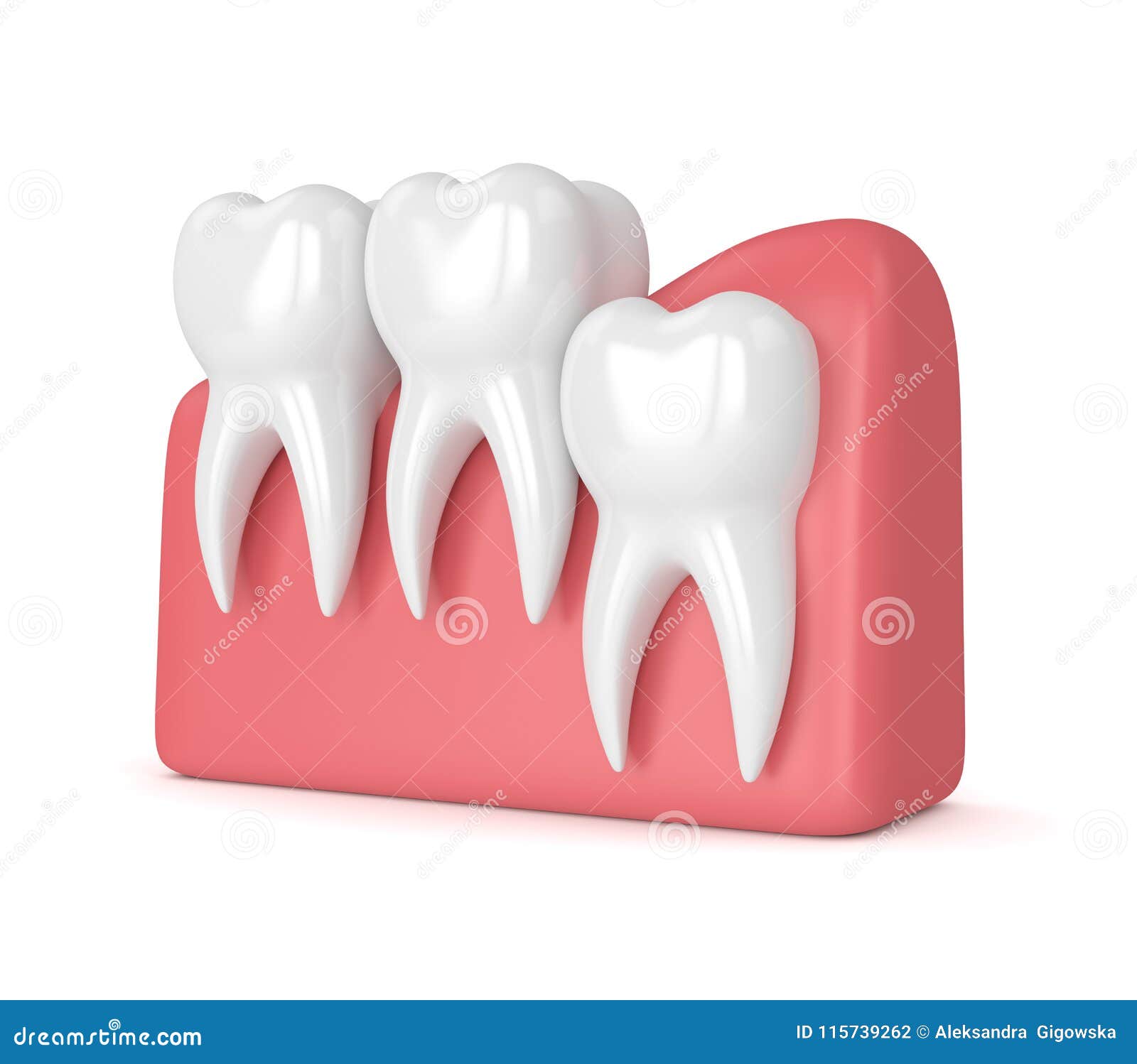 3d Render of Teeth with Wisdom Vertical Impaction Stock Illustration ...