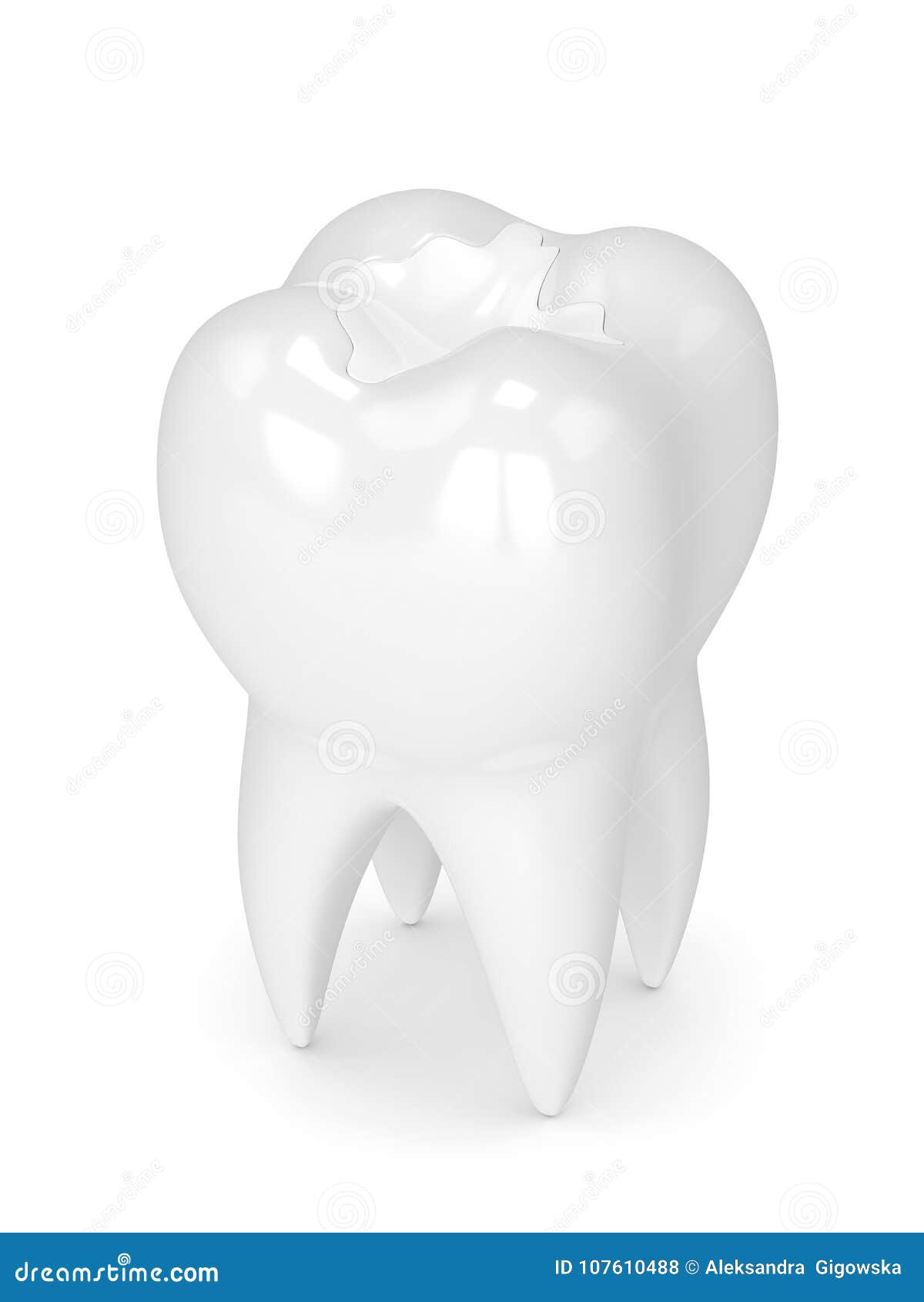 3d Render of Tooth with Dental Composite Filling Stock Illustration ...