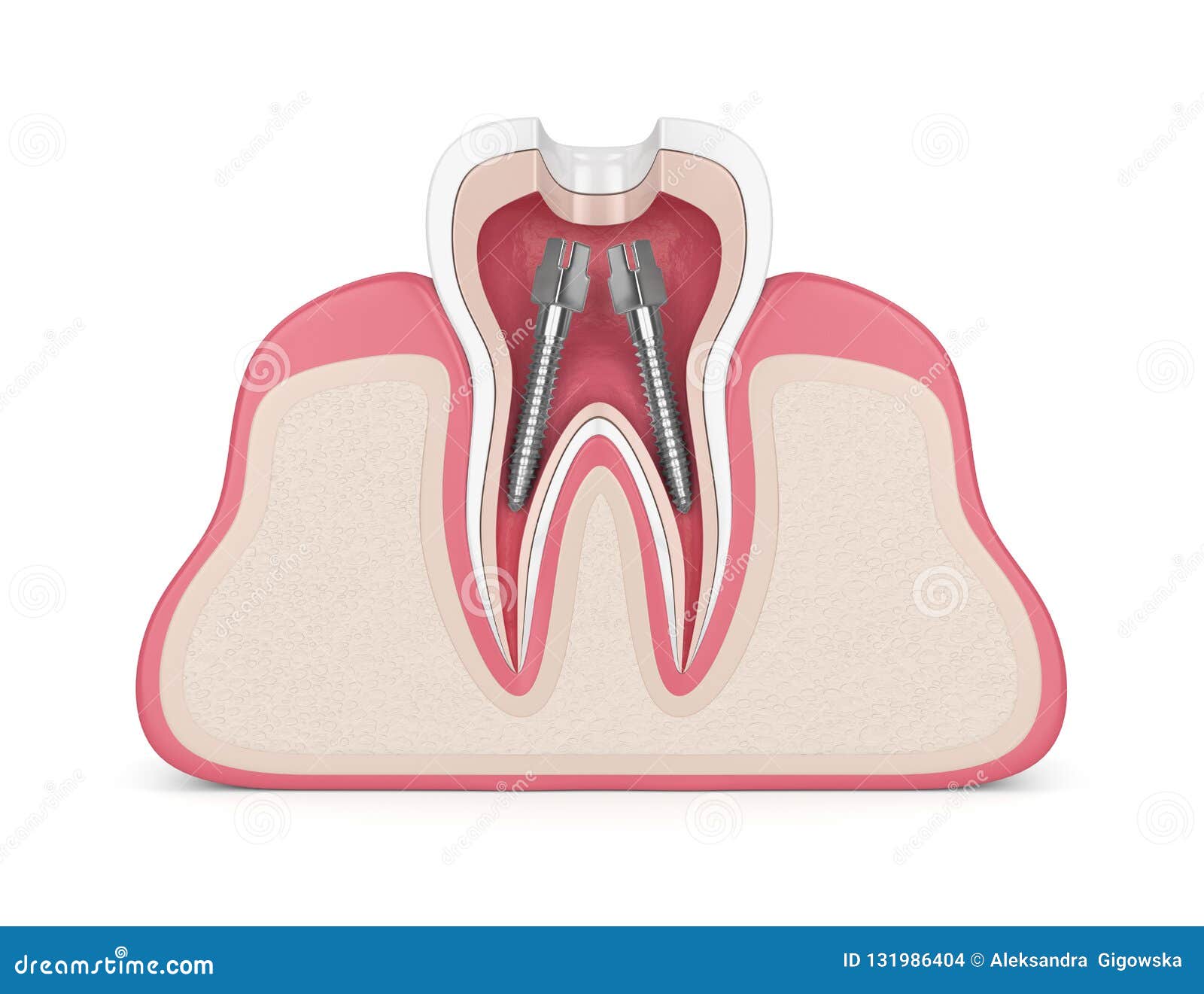 3d Render of Tooth with Dental Root Canal Posts Stock Illustration ...