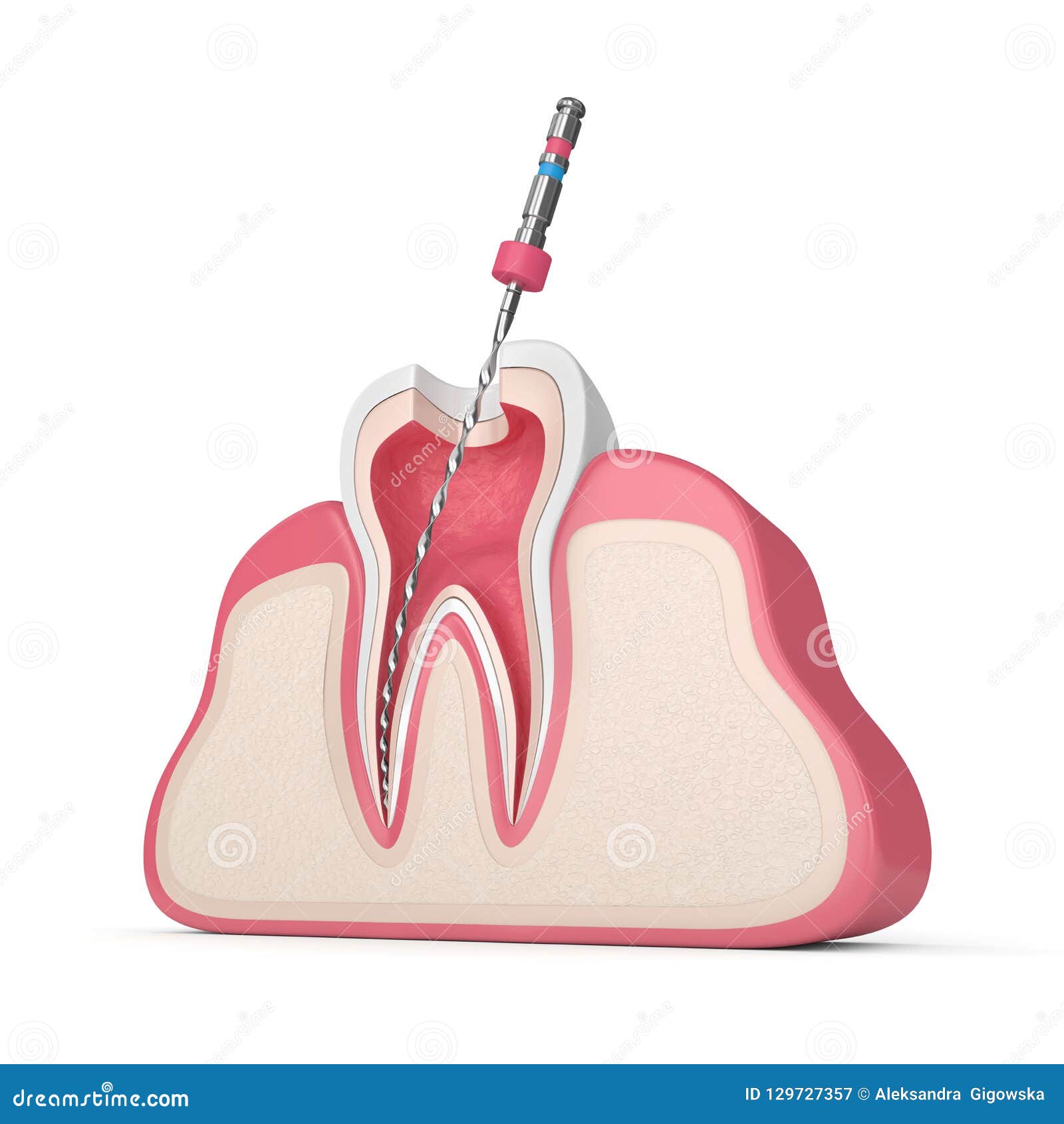 Tooth With Endodontic File. Root Canal Treatment Concept. Endodontics ...