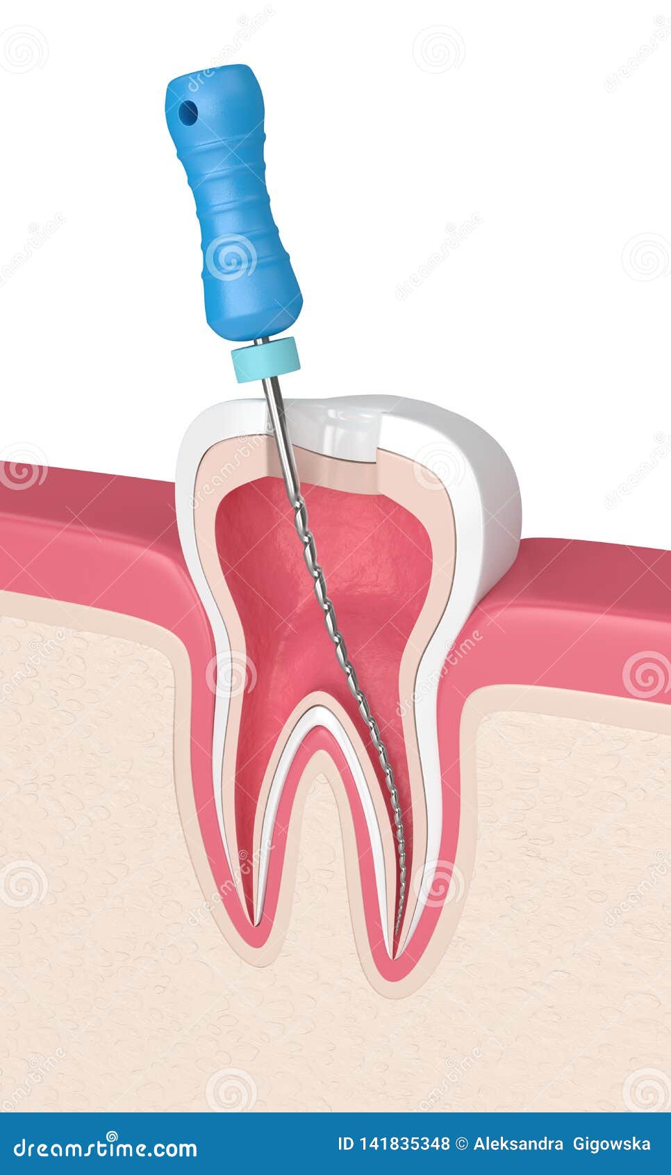 3d Render of Tooth with Endodontic File in Gums Stock Illustration ...