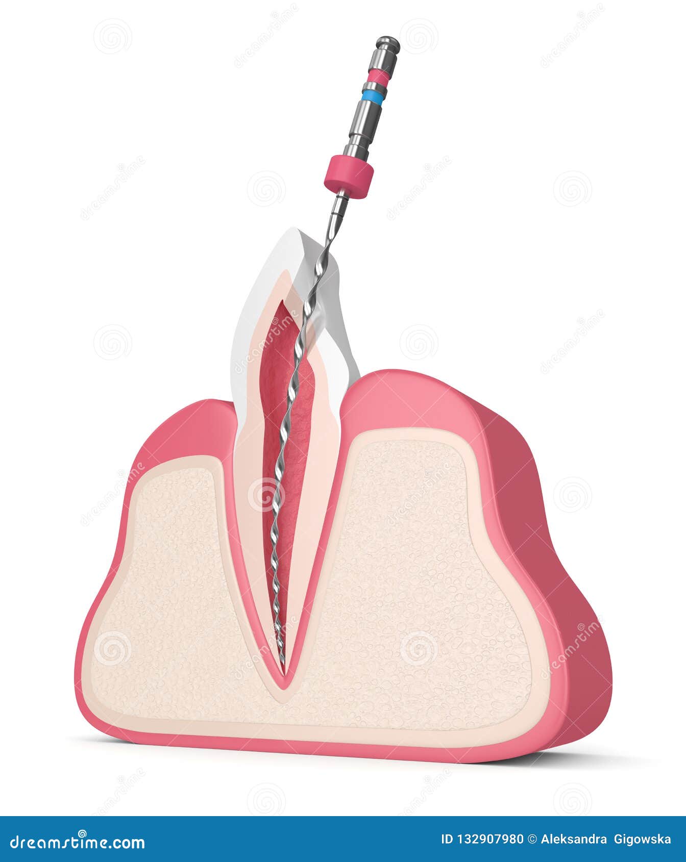 3d Render of Tooth with Endodontic File in Gums Stock Illustration ...