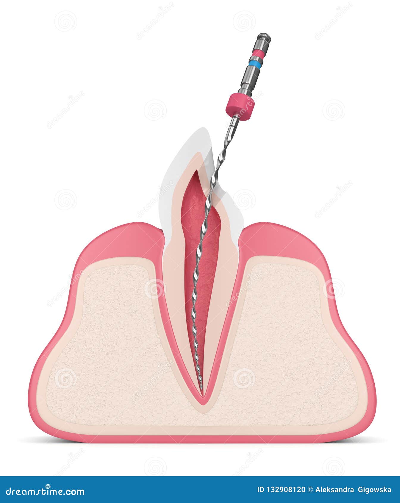 3d Render of Tooth with Endodontic File in Gums Stock Illustration ...