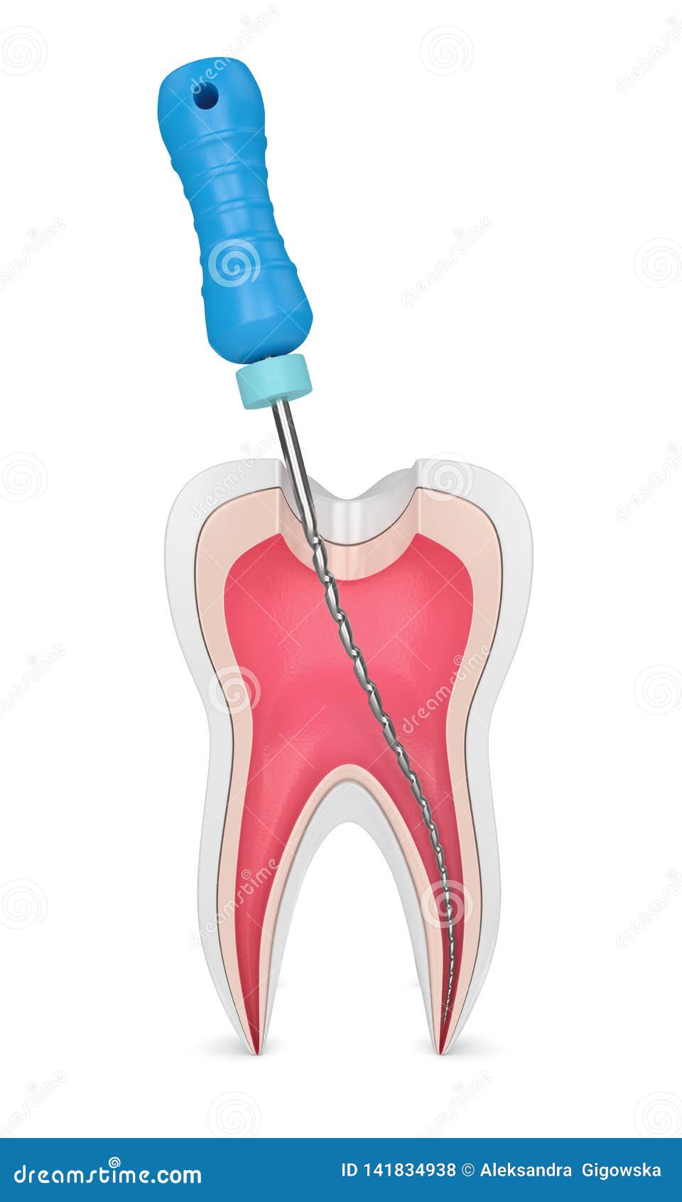 3d Render Of Tooth With Endodontic File Stock Photo | CartoonDealer.com ...