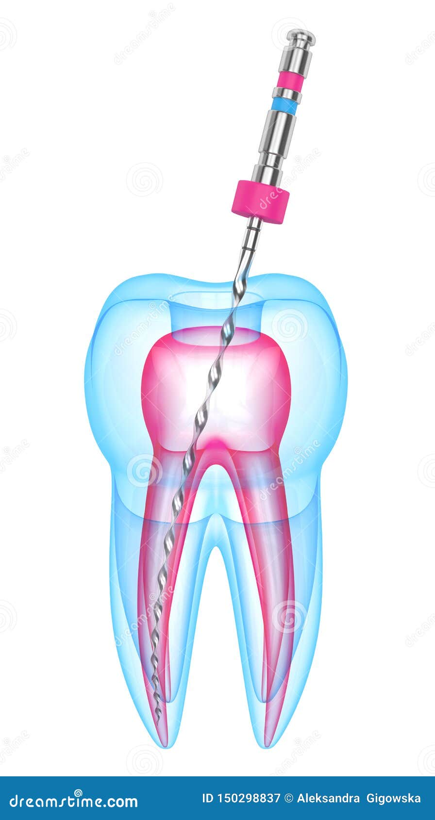 3d Render of Tooth with Endodontic File Over White Background Stock ...