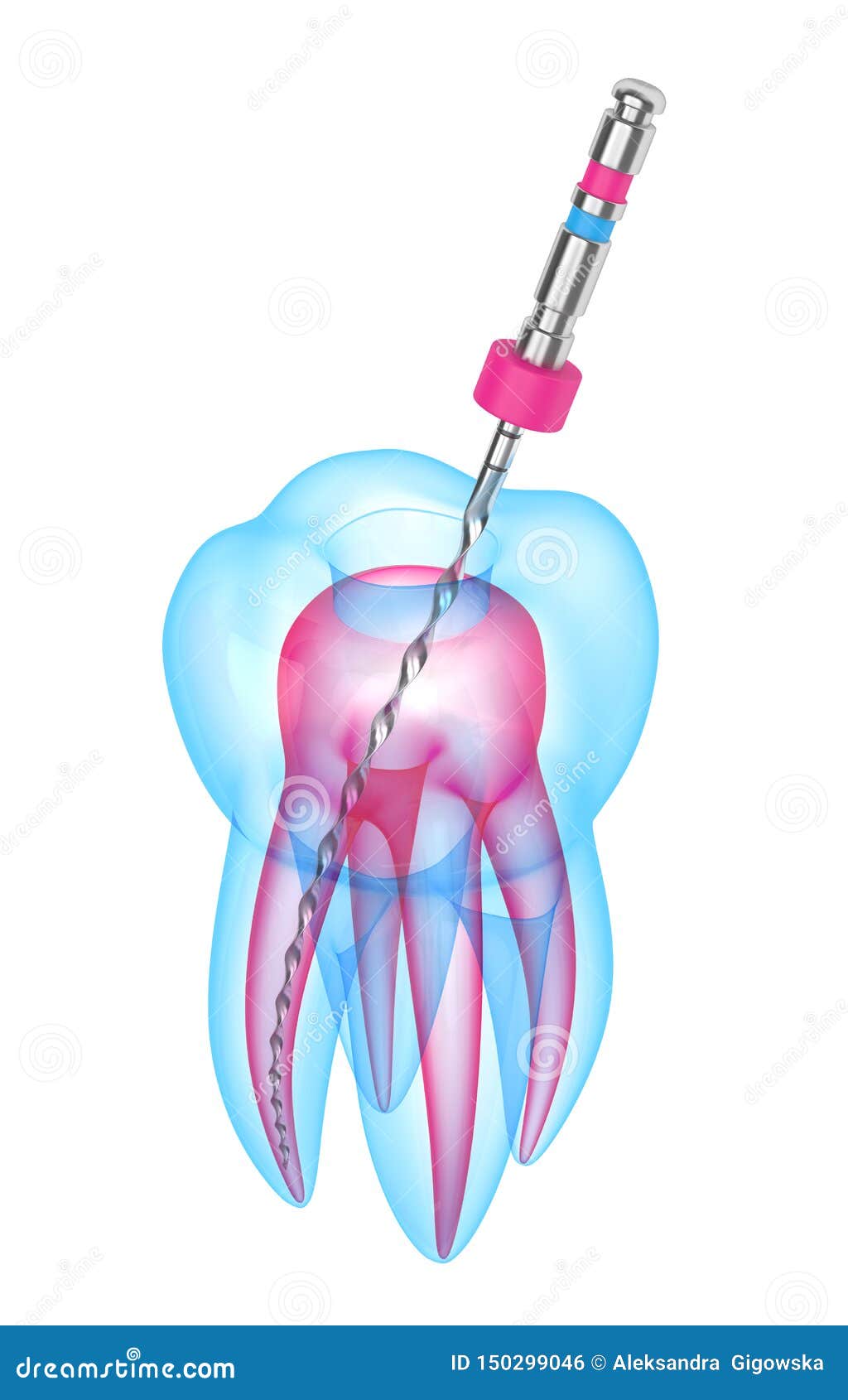 Tooth With Endodontic File. Root Canal Treatment Concept. Endodontics ...