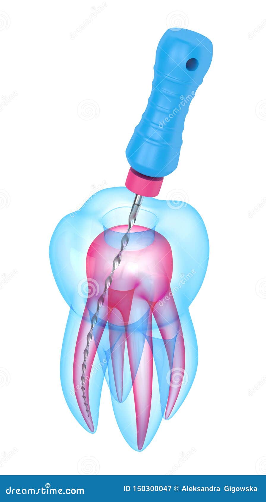 Tooth With Endodontic File. Root Canal Treatment Concept. Endodontics ...