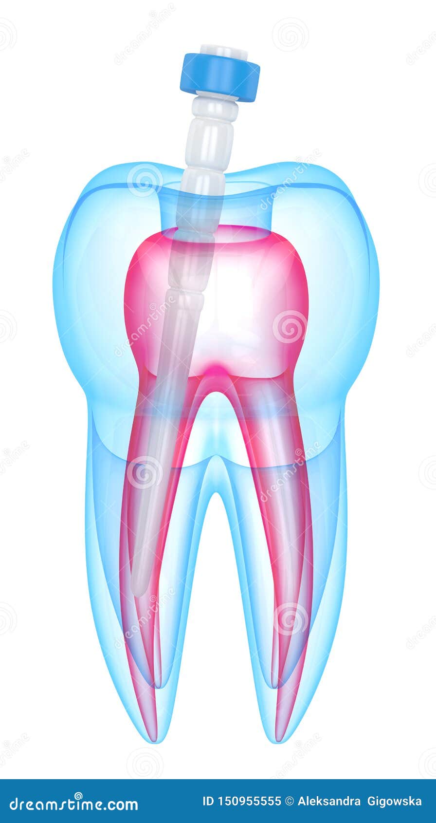 3d Render of Tooth with Fiber Post Over White Stock Illustration ...