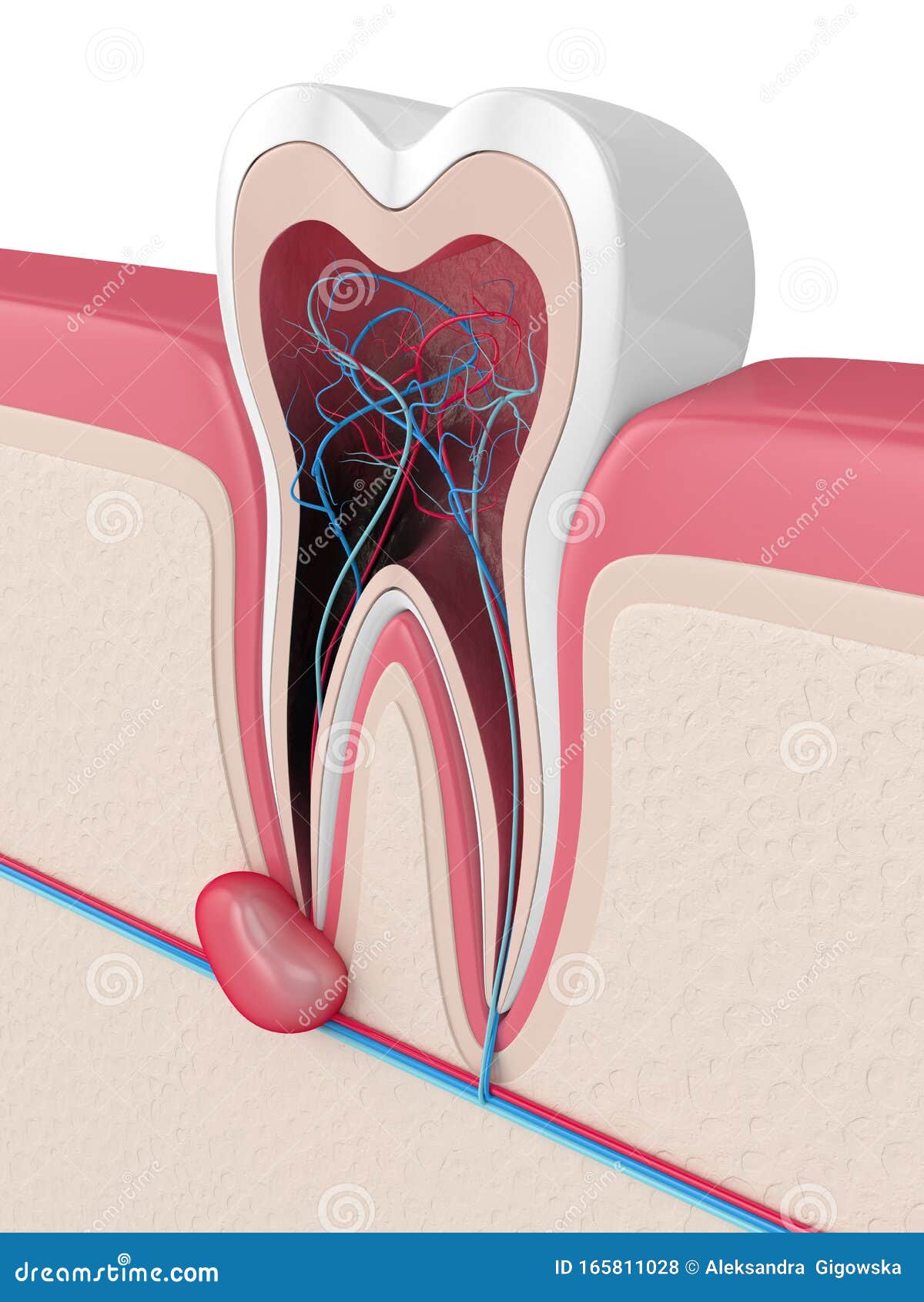 3d Render of Tooth in Gums with Cyst Stock Illustration - Illustration ...