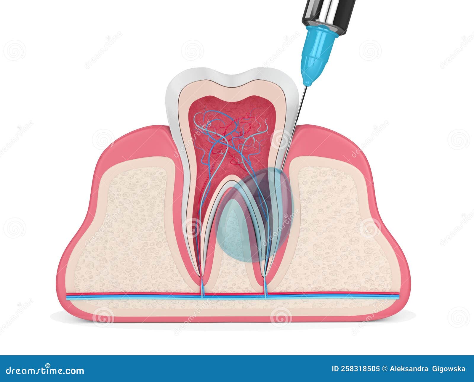 3d Render Of Tooth In Gums With Intraligamentary Anesthesia Procedure ...