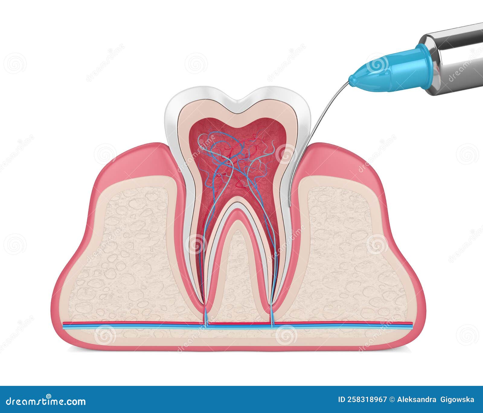 3d Render of Tooth in Gums with Intraligamentary Anesthesia Procedure ...