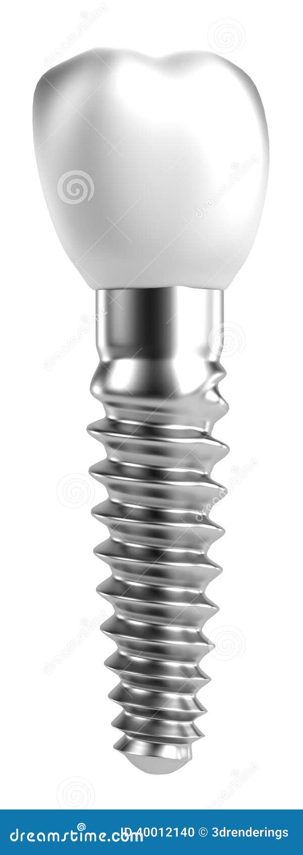 3d Render Of Jaw With Implant Screw And Buried Healing Cap Under Gums ...