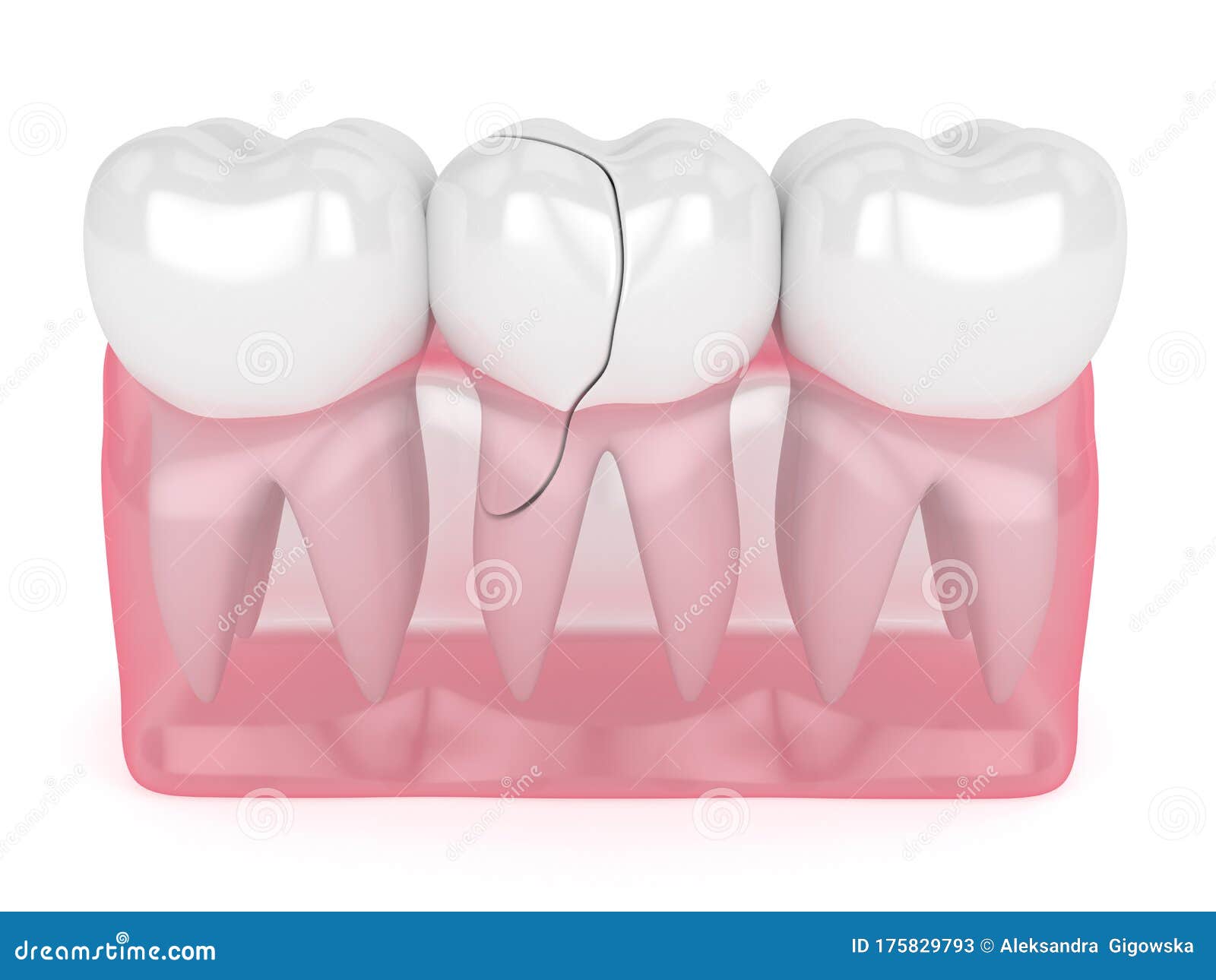 3d Render of Translucent Gums with Cracked Tooth Stock Illustration ...