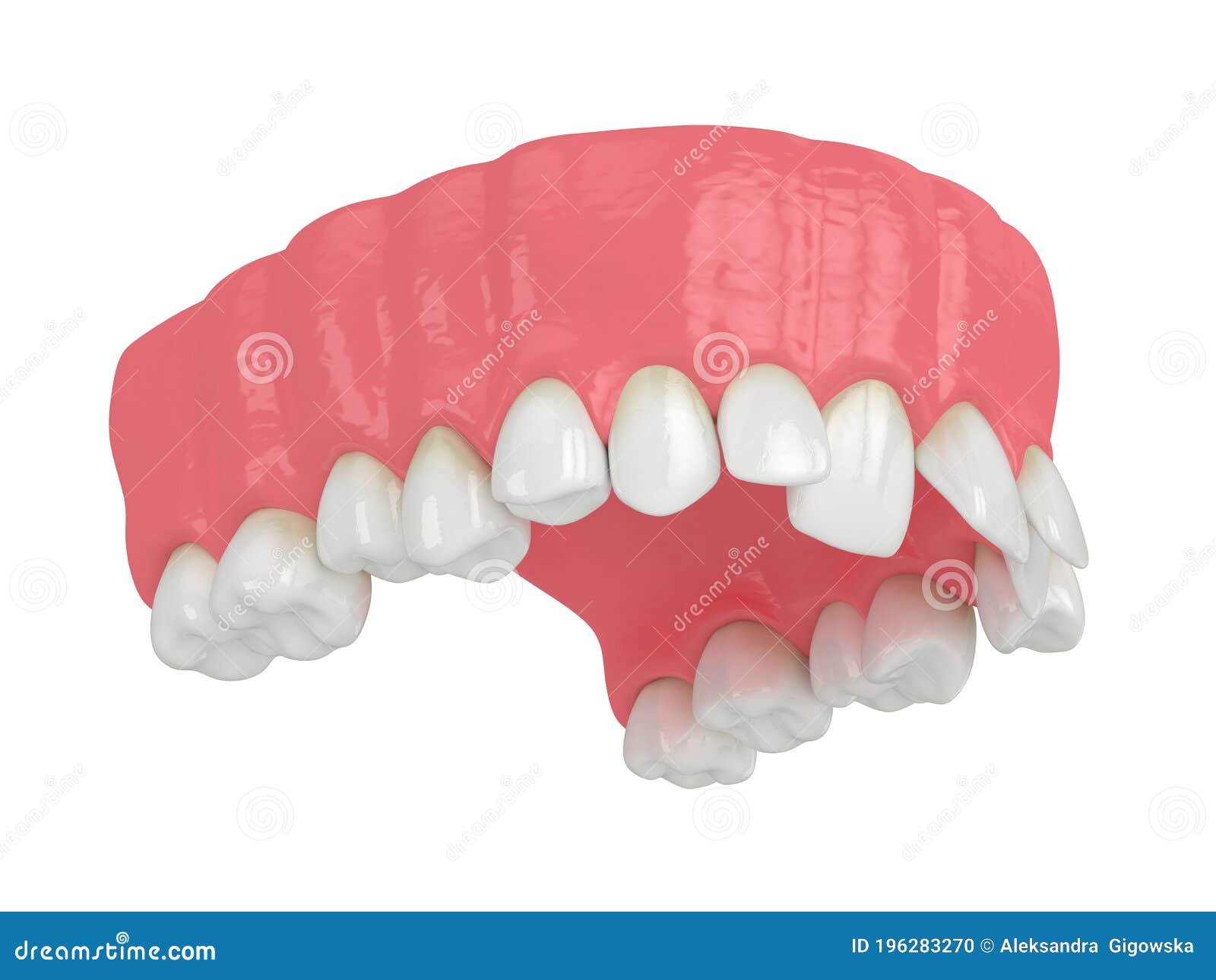3d Render Of Jaw With Abnormal Teeth Position Royalty-Free Stock ...