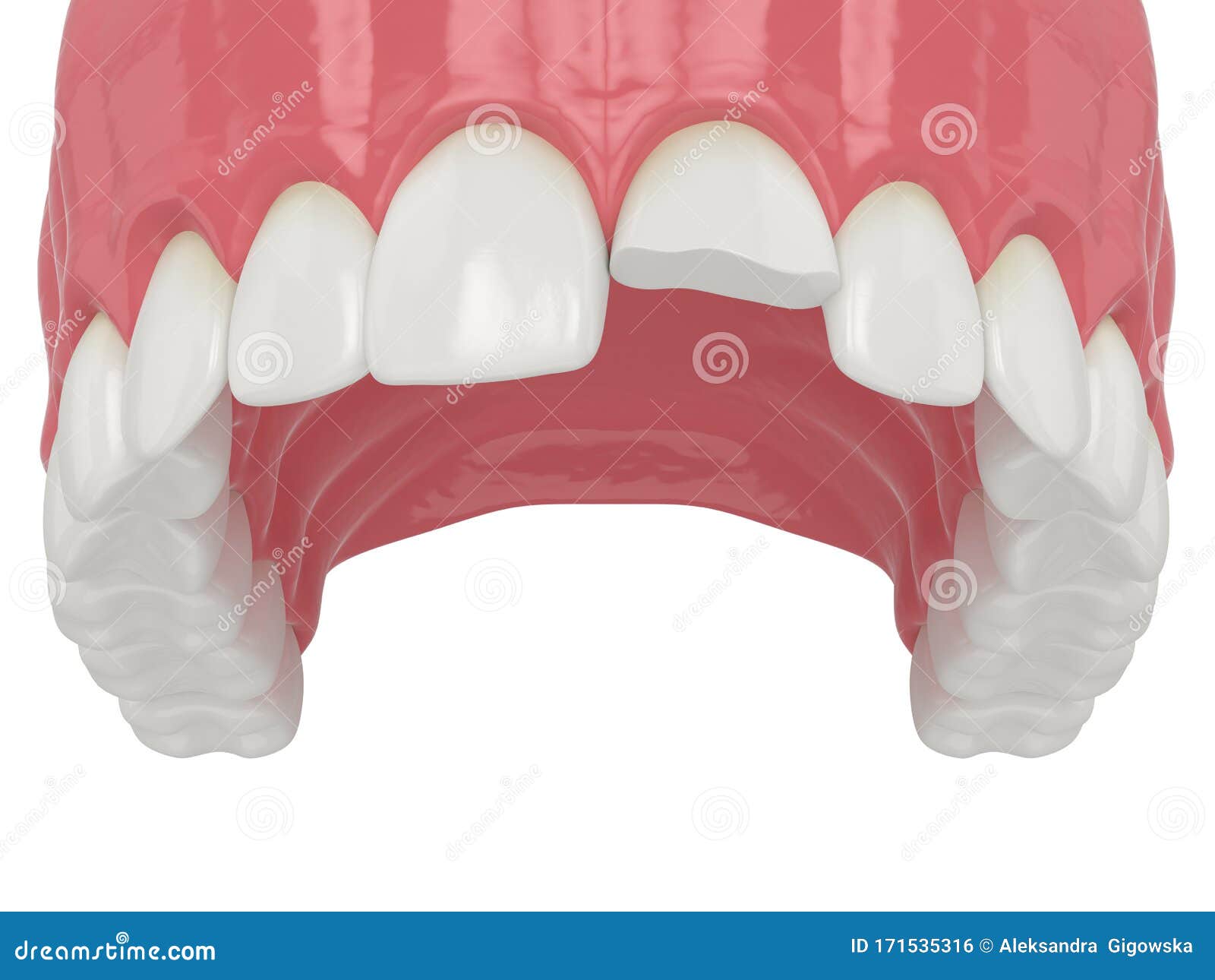 3d Render Of Upper Jaw With Teeth And Dental Lateral Incisor Imp Stock ...