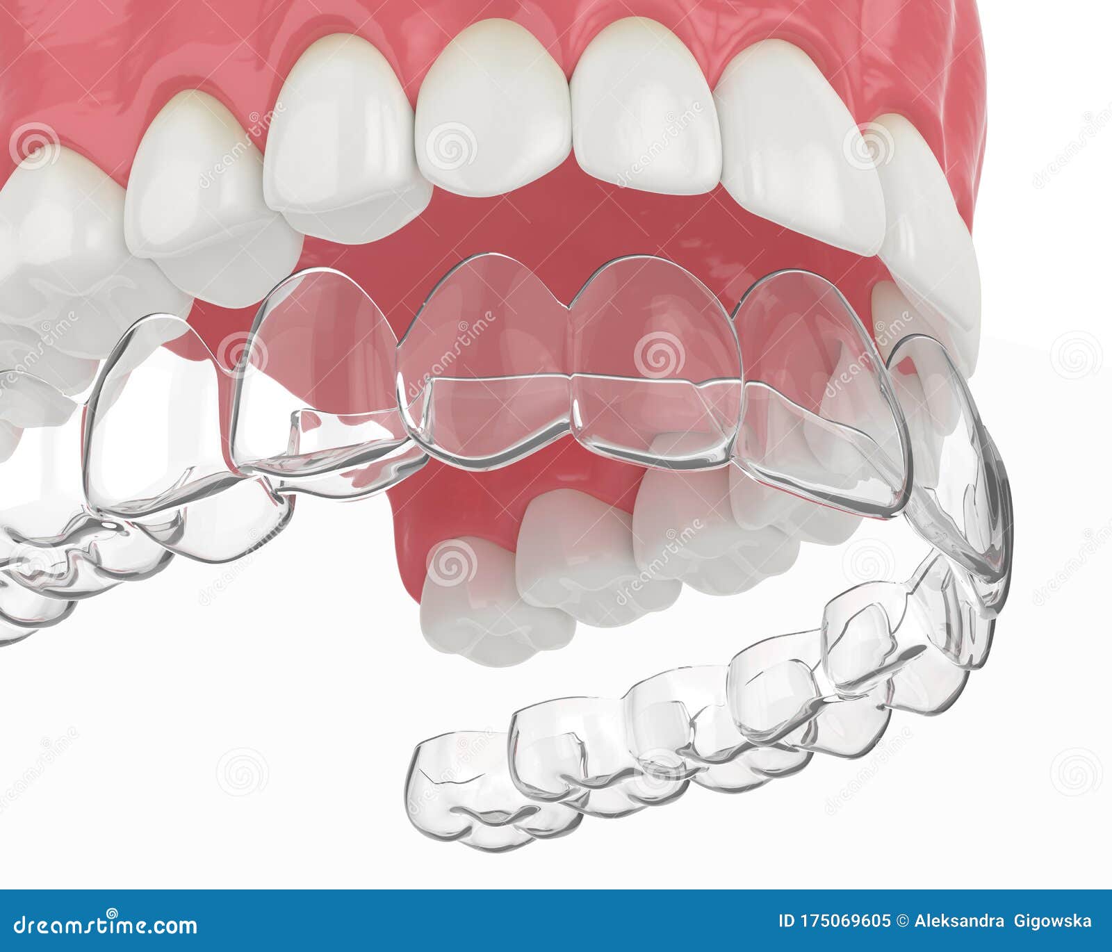 Invisalign Cartoons, Illustrations & Vector Stock Images - 511 Pictures ...