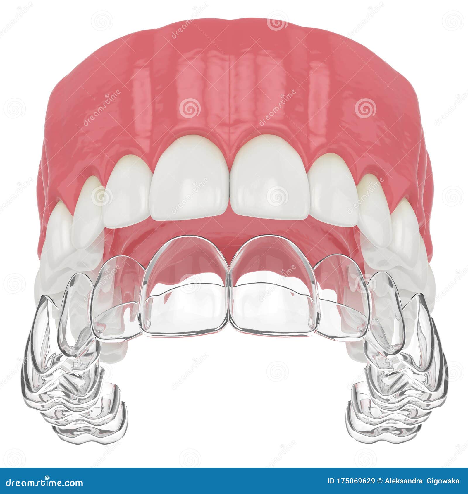 3d Render of Upper Jaw with Invisalign Removable Retainer Stock ...