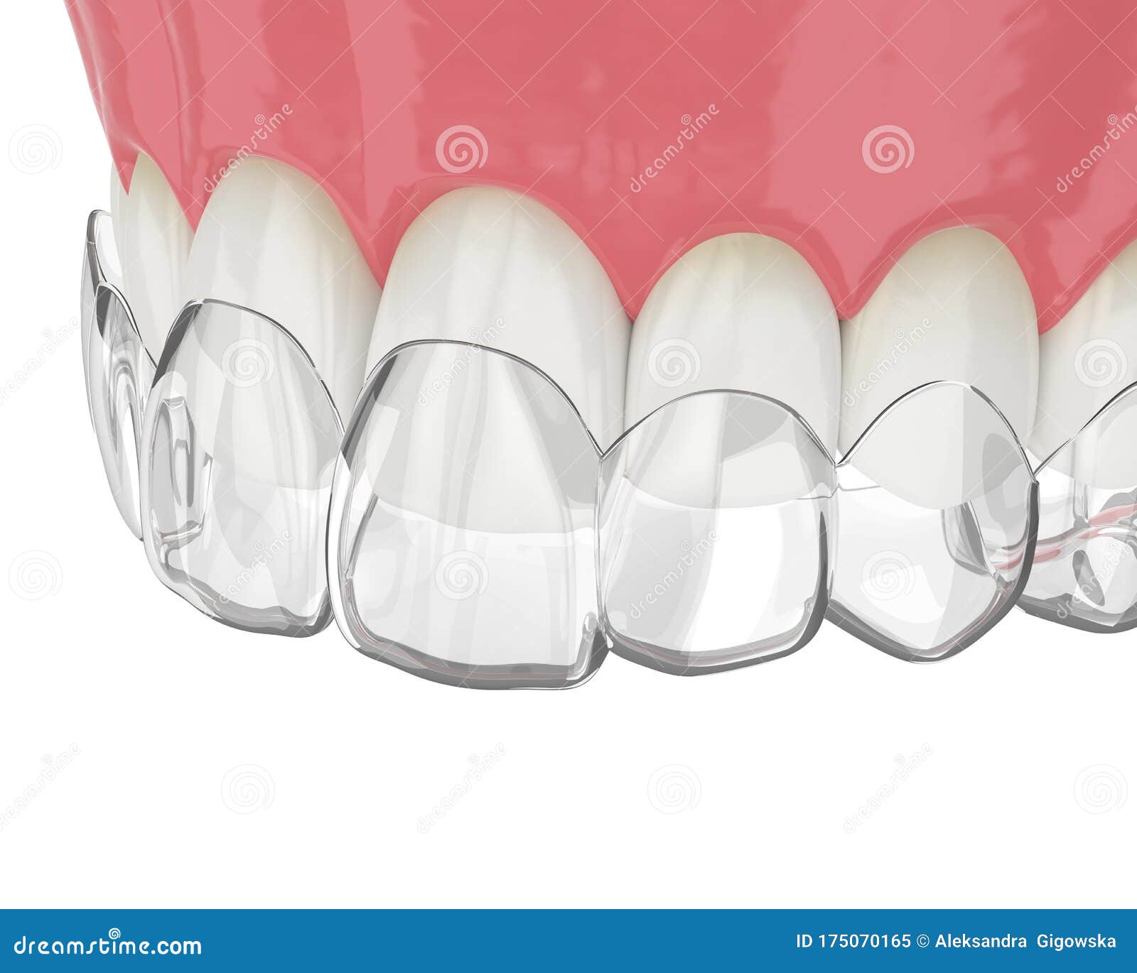 Invisalign Cartoons, Illustrations & Vector Stock Images - 511 Pictures ...