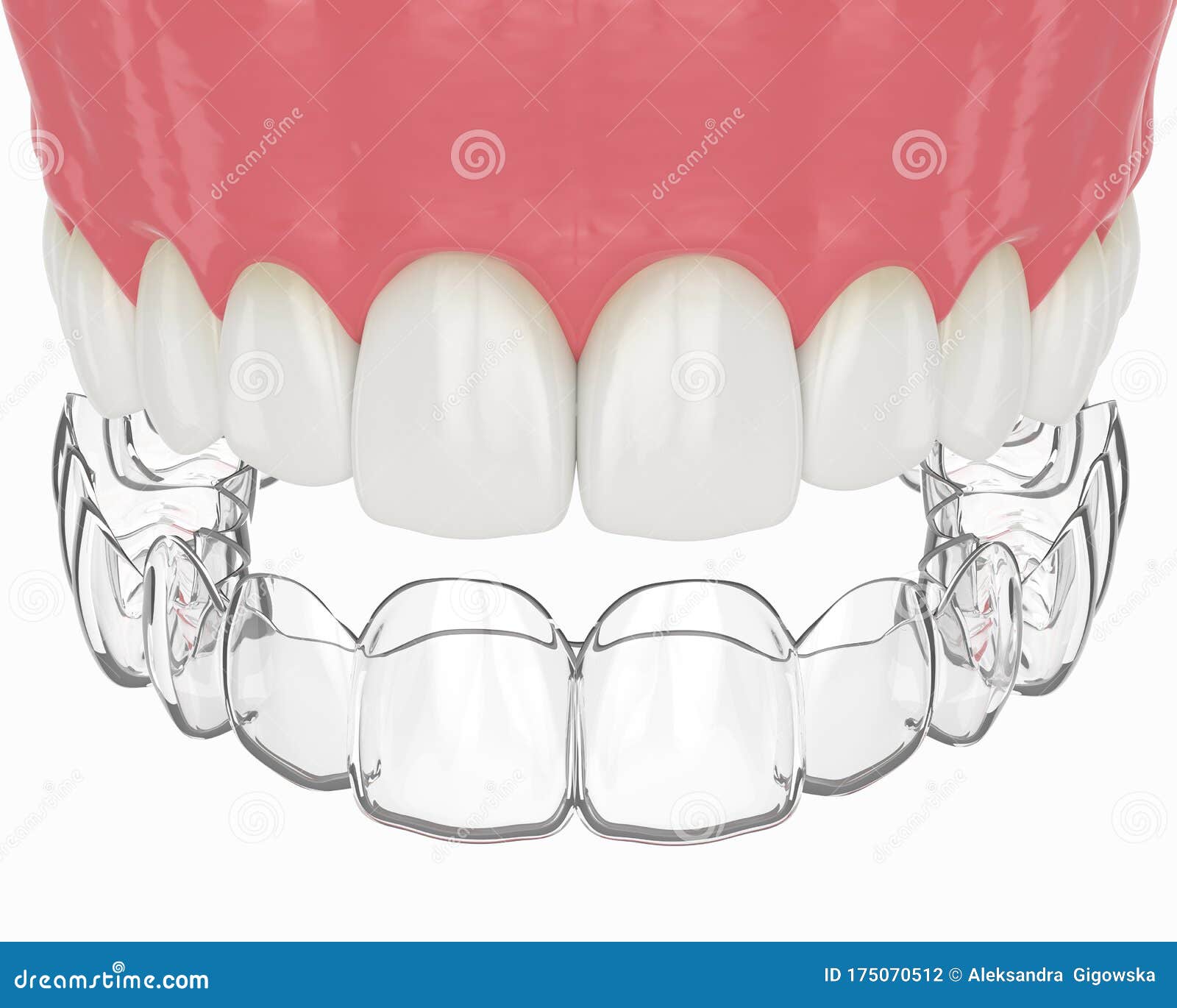 3d Render of Upper Jaw with Invisalign Removable Retainer Stock ...