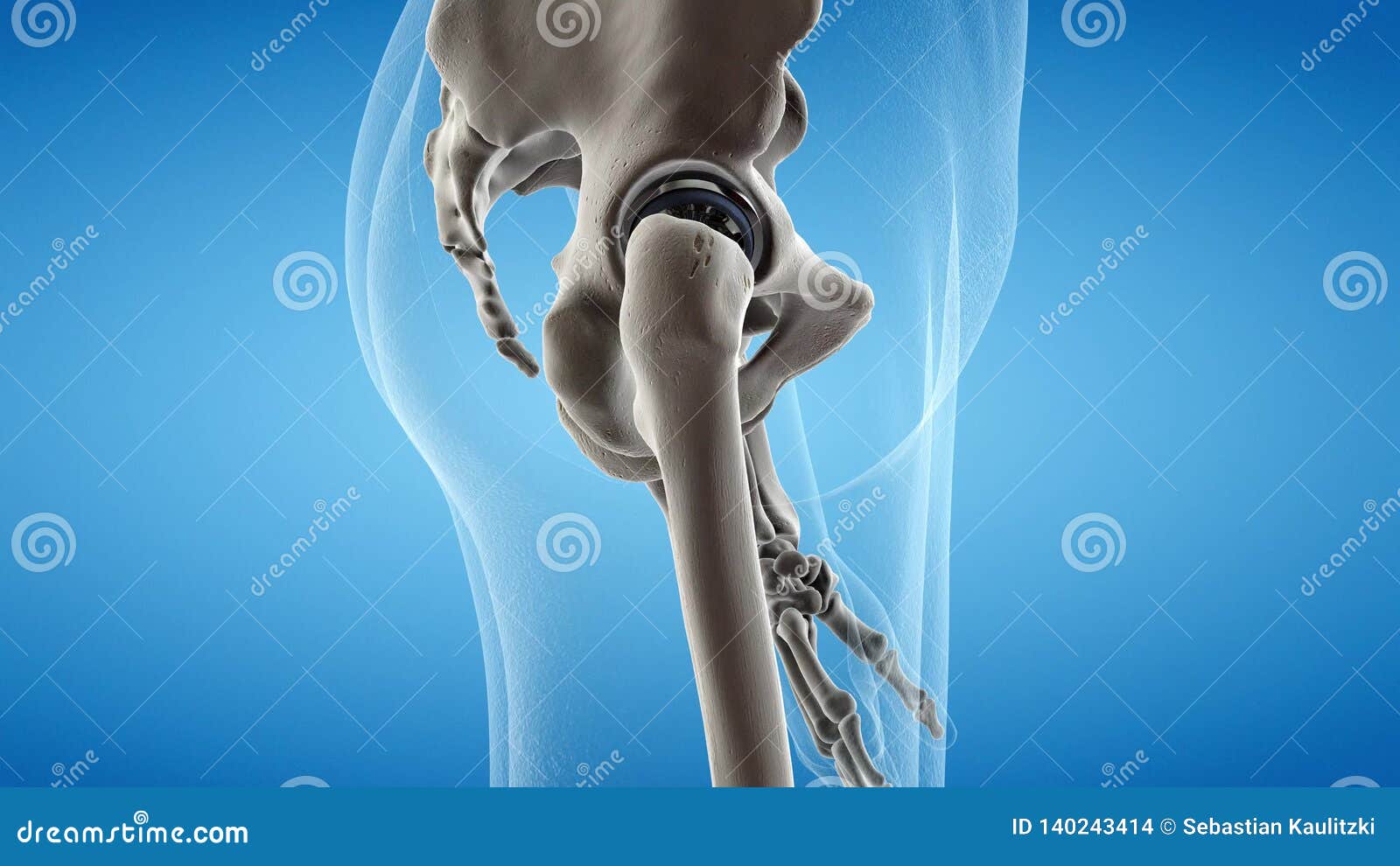 A hip replacement stock footage. Video of graphic, orthopedics - 140243414