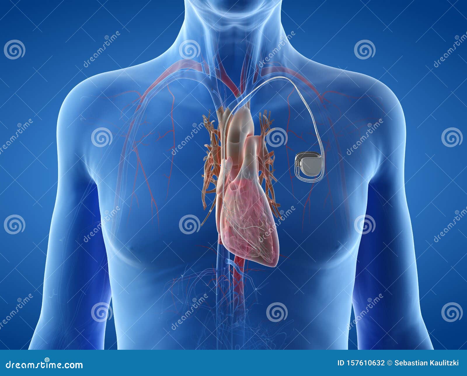 A pace maker stock illustration. Illustration of medicine - 157610632