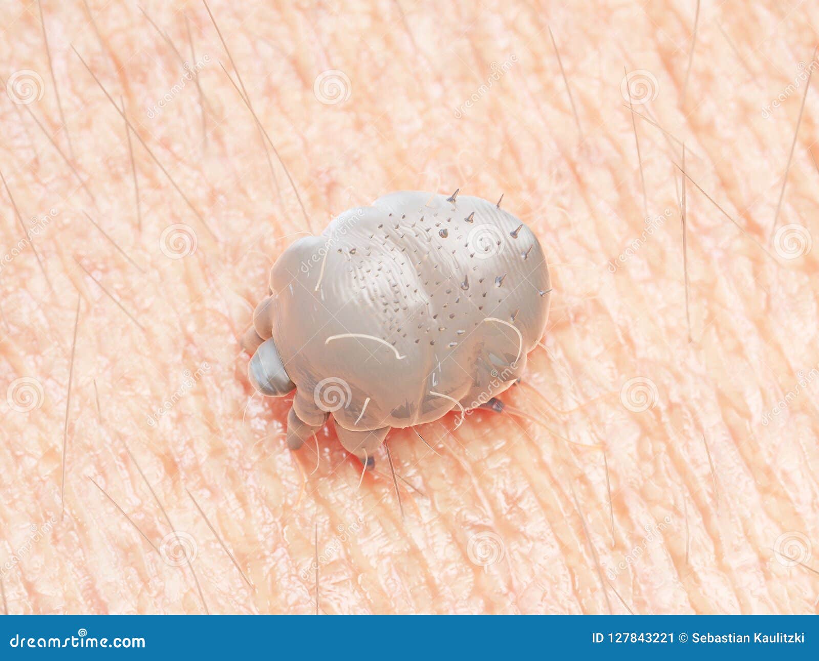 Scabies Mite. Human`s Hand. Skin With Rashes Cartoon Vector ...