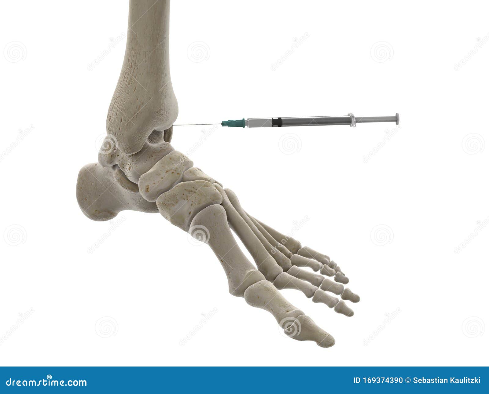 An ankle injection stock illustration. Illustration of articular ...