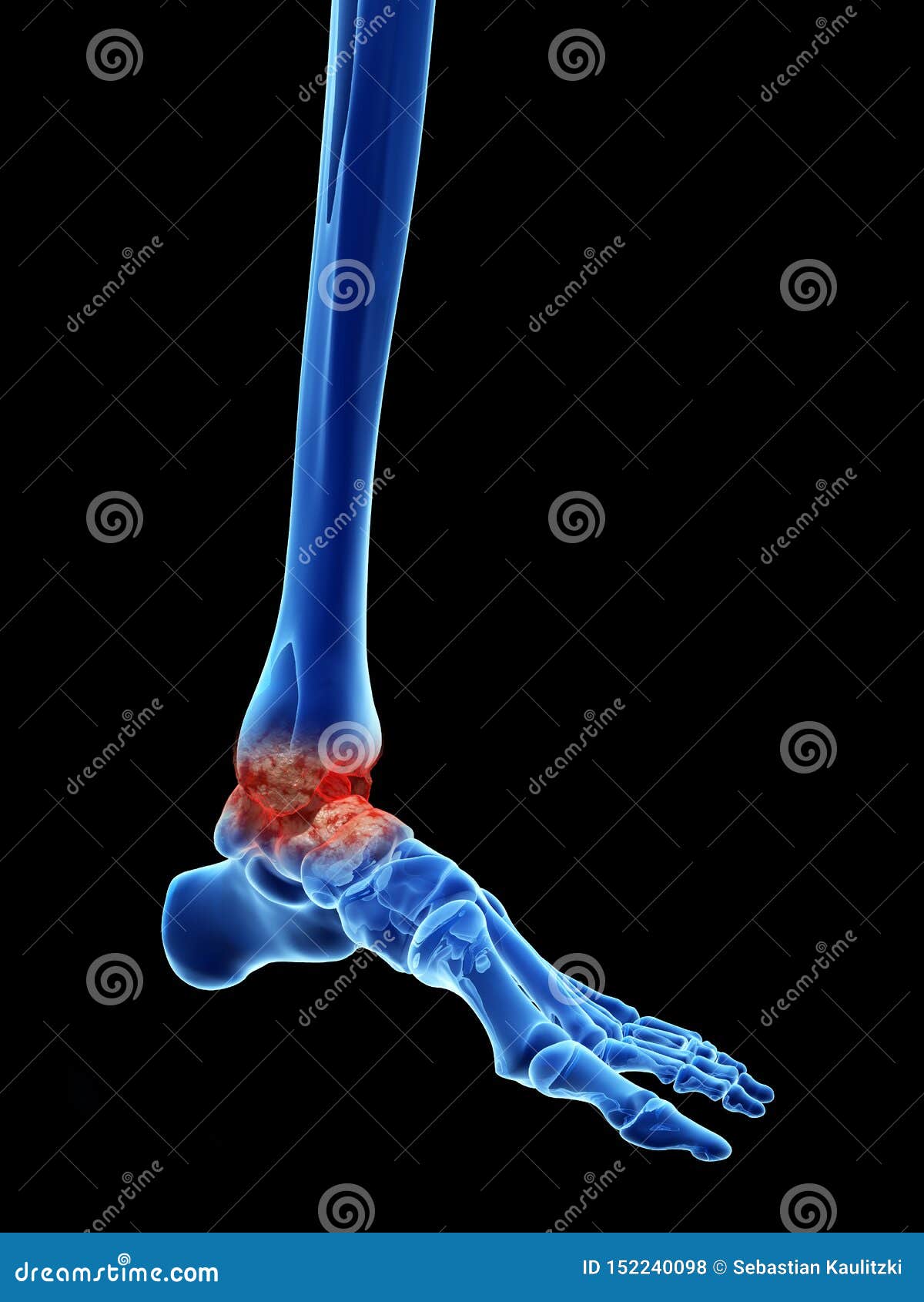 Arthrosis in the ankle stock illustration. Illustration of anatomical ...