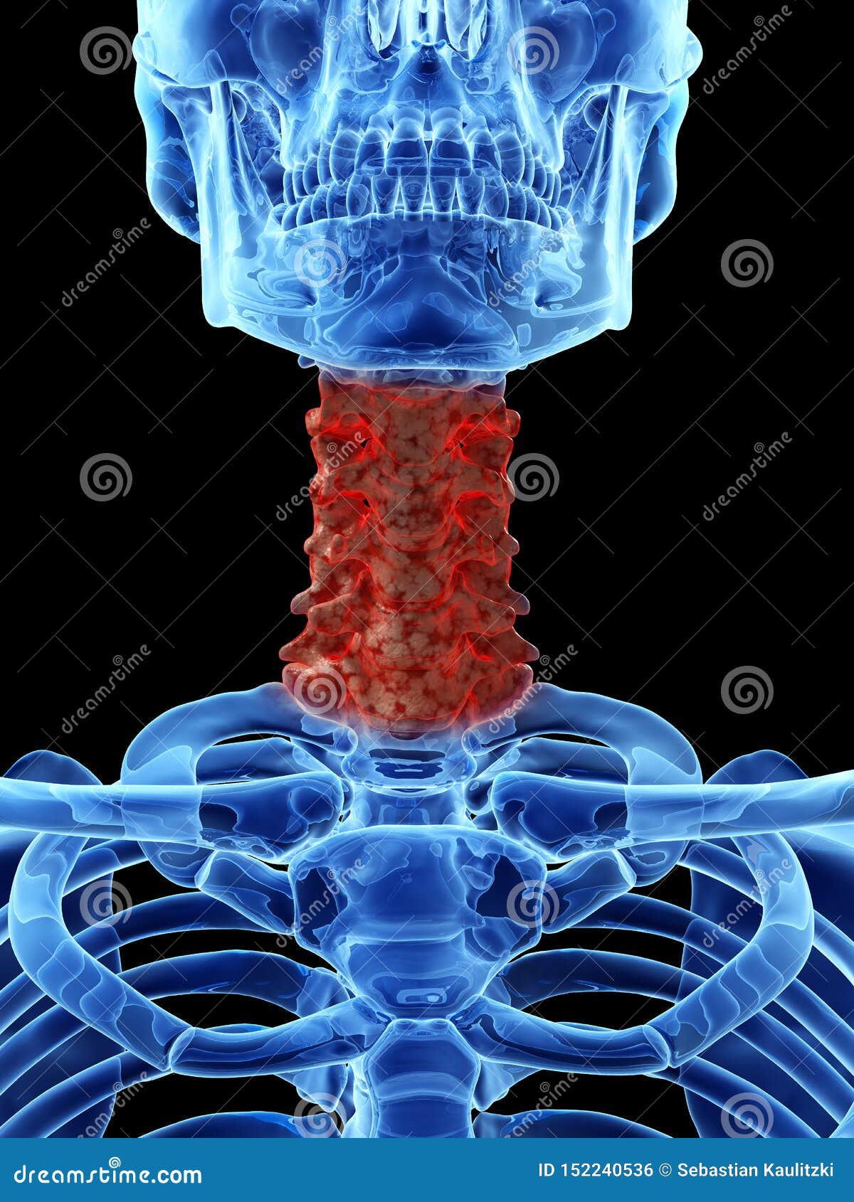 Arthrosis In The Cervical Spine Royalty-Free Illustration ...
