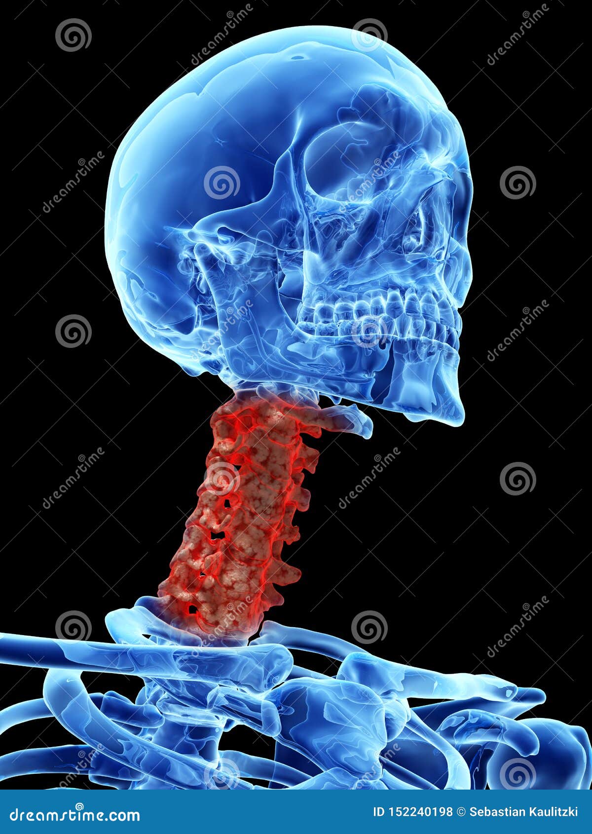 Arthrosis In The Cervical Spine Royalty-Free Illustration ...